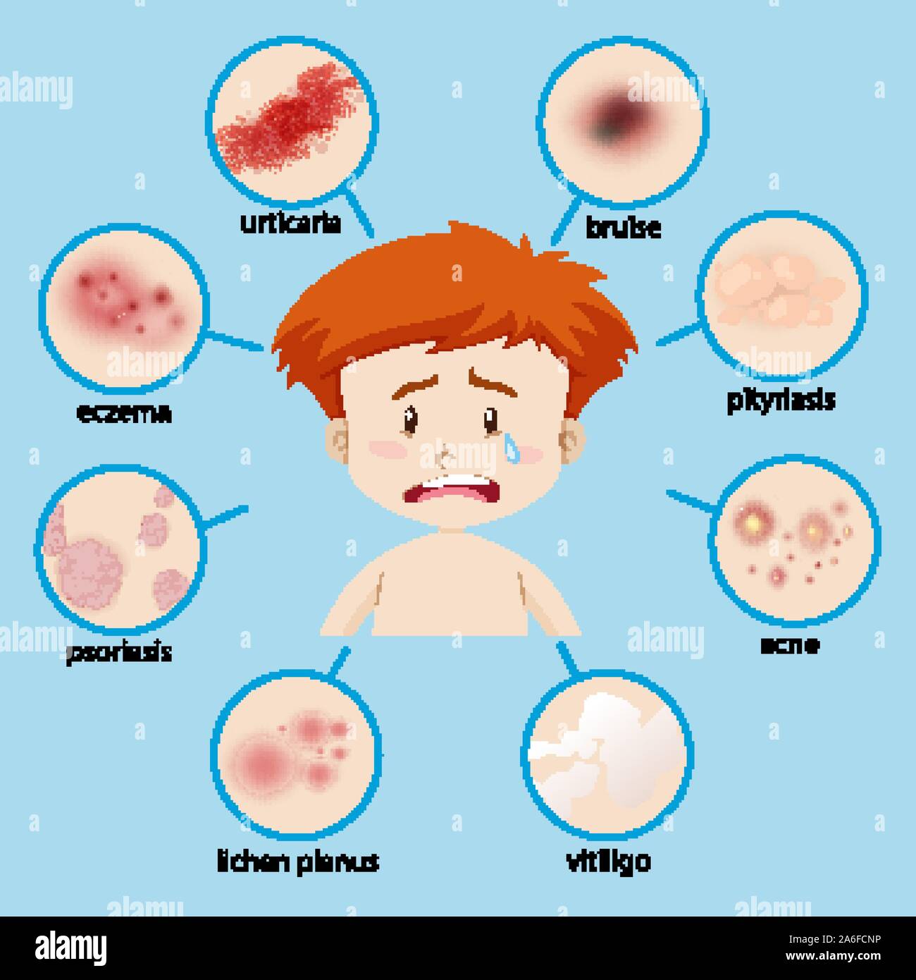 Diagram showing boy with different skin conditions illustration Stock ...