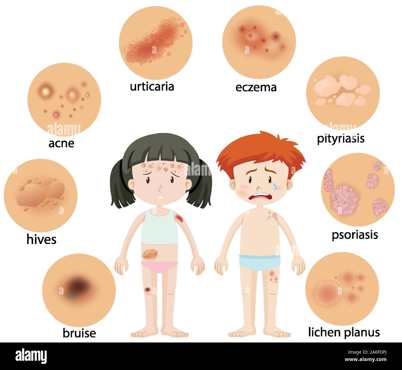 Different skin conditions on human girl and boy illustration Stock ...