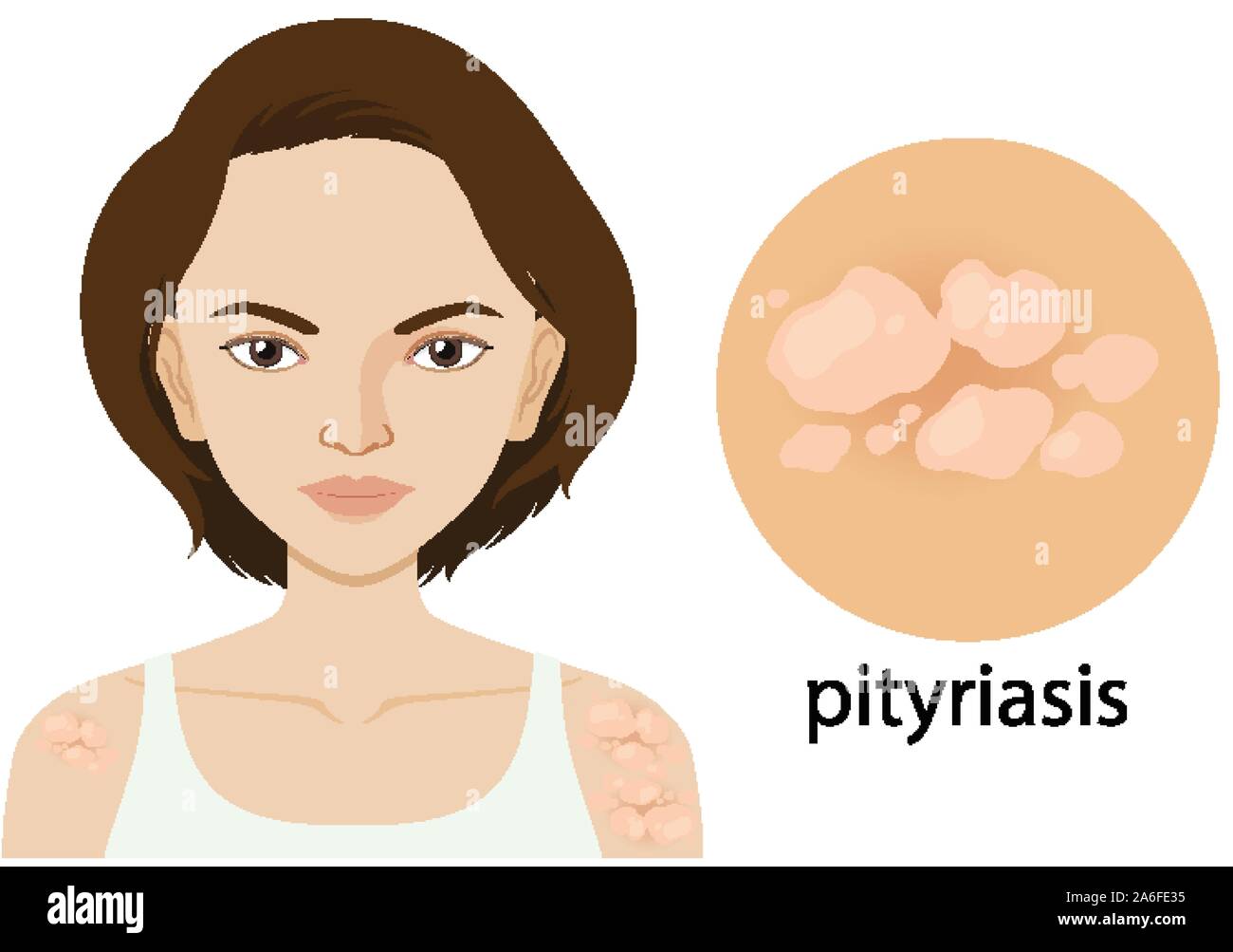 Diagram showing woman with pityriasis illustration Stock Vector Image ...