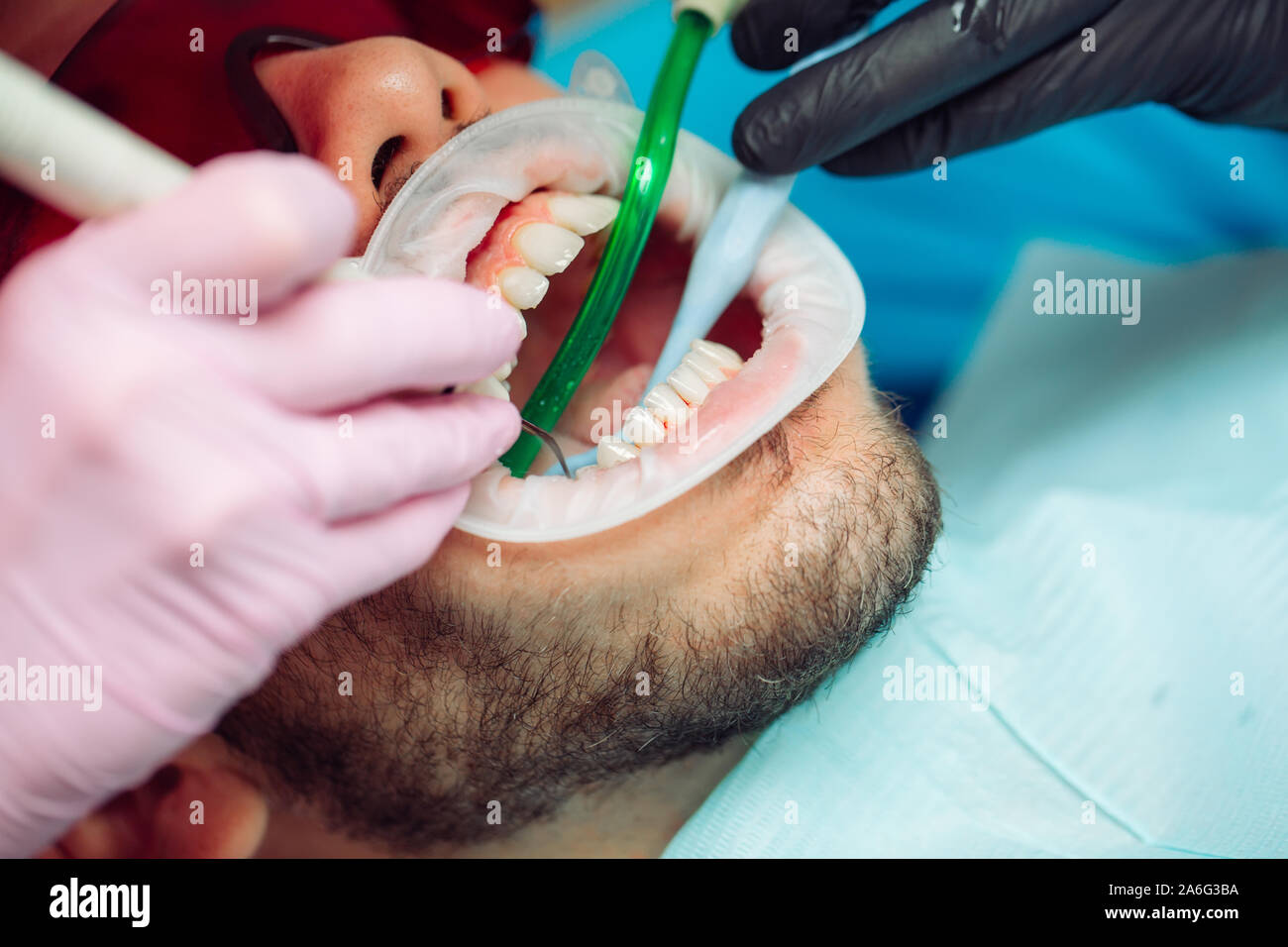 Professional teeth cleaning. Dentist cleans the teeth of a male patient ...