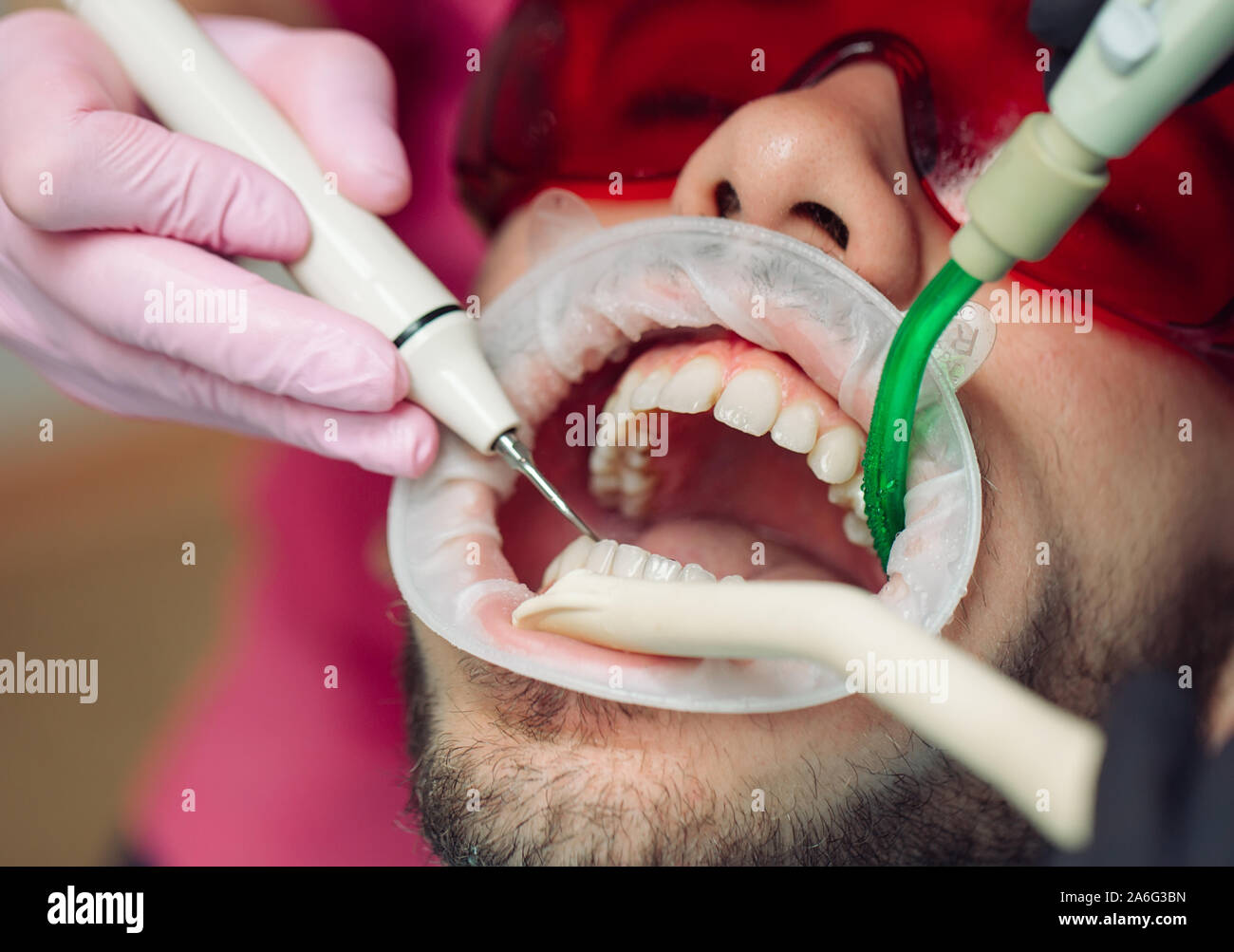 Professional teeth cleaning. Dentist cleans the teeth of a male patient ...