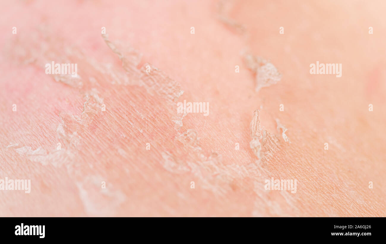 Sunburns of body, closeup. Skin damaged by sun, peeling. Body care ...