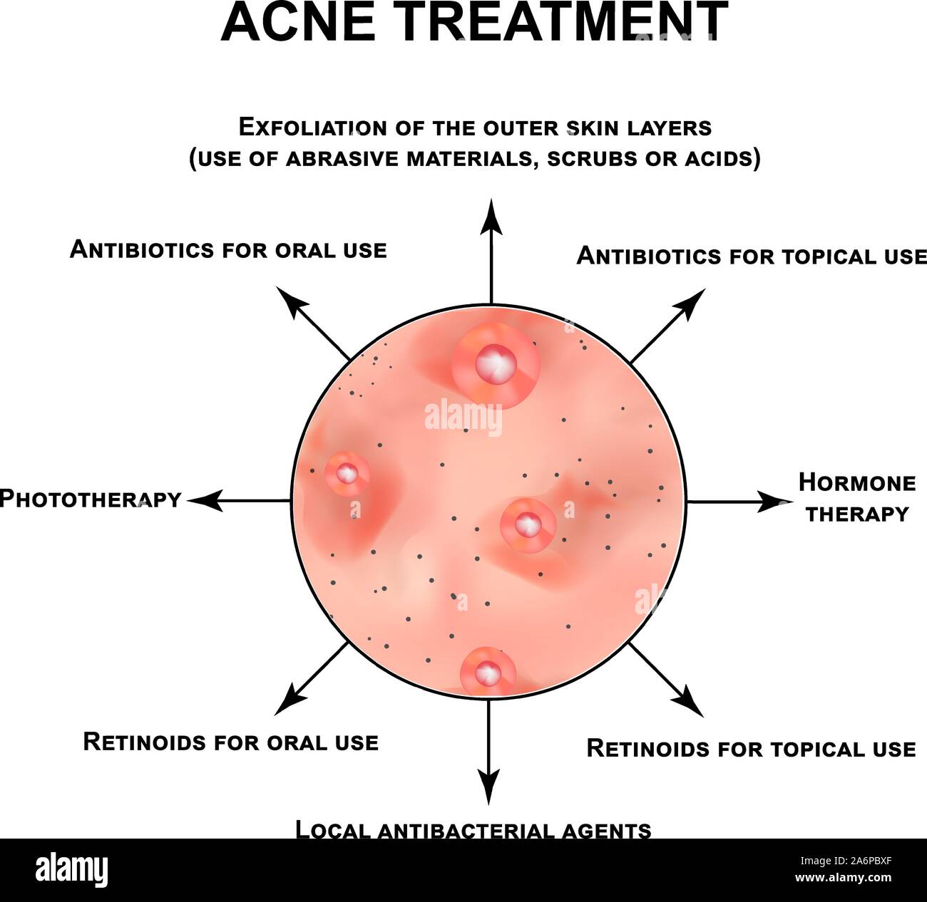 How To Treat Papules Acne