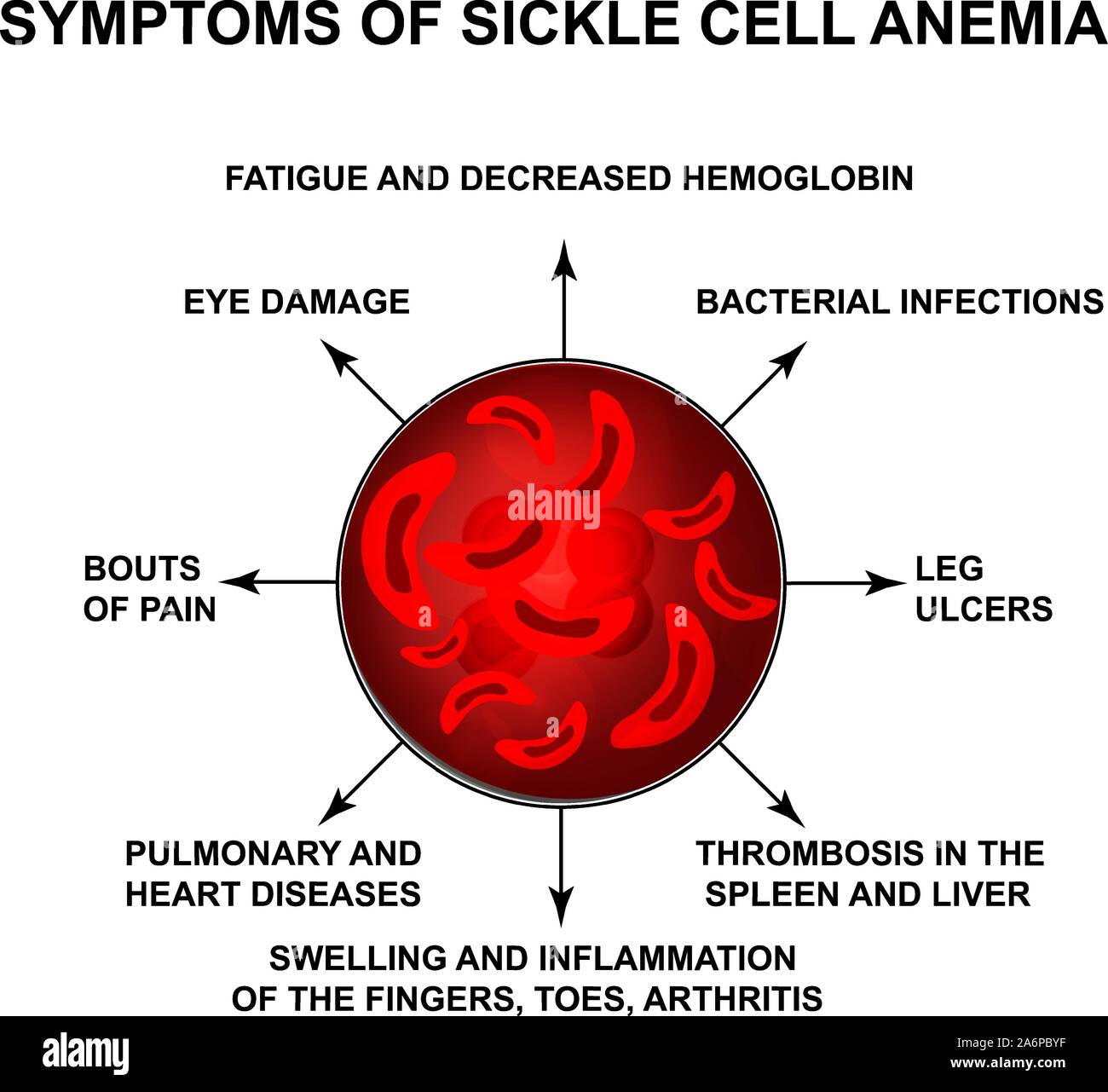 Symptoms of sickle cell anemia. World Sickle Cell Anemia Day 19 June ...