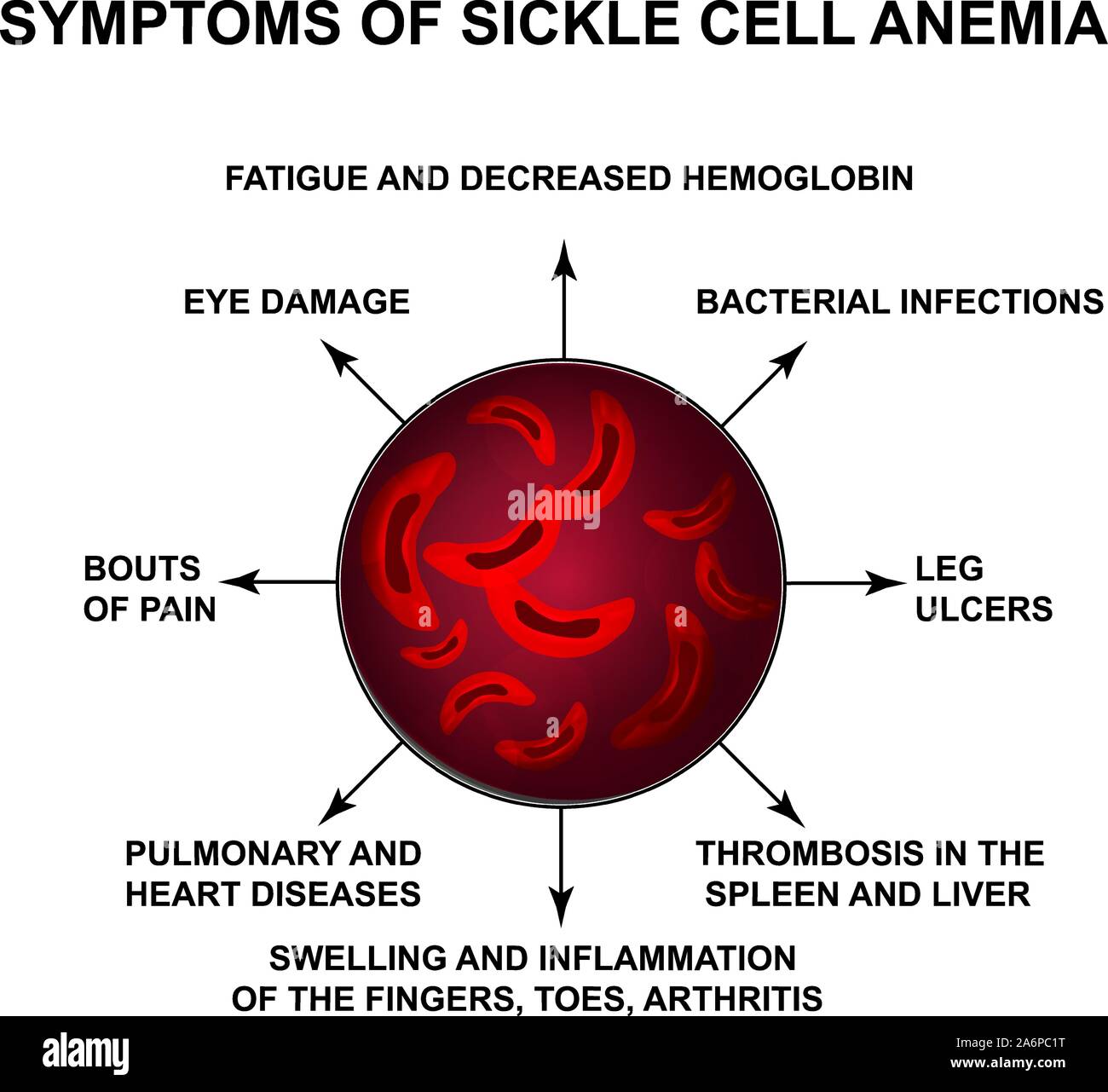Symptoms of sickle cell anemia. World Sickle Cell Anemia Day 19 June ...