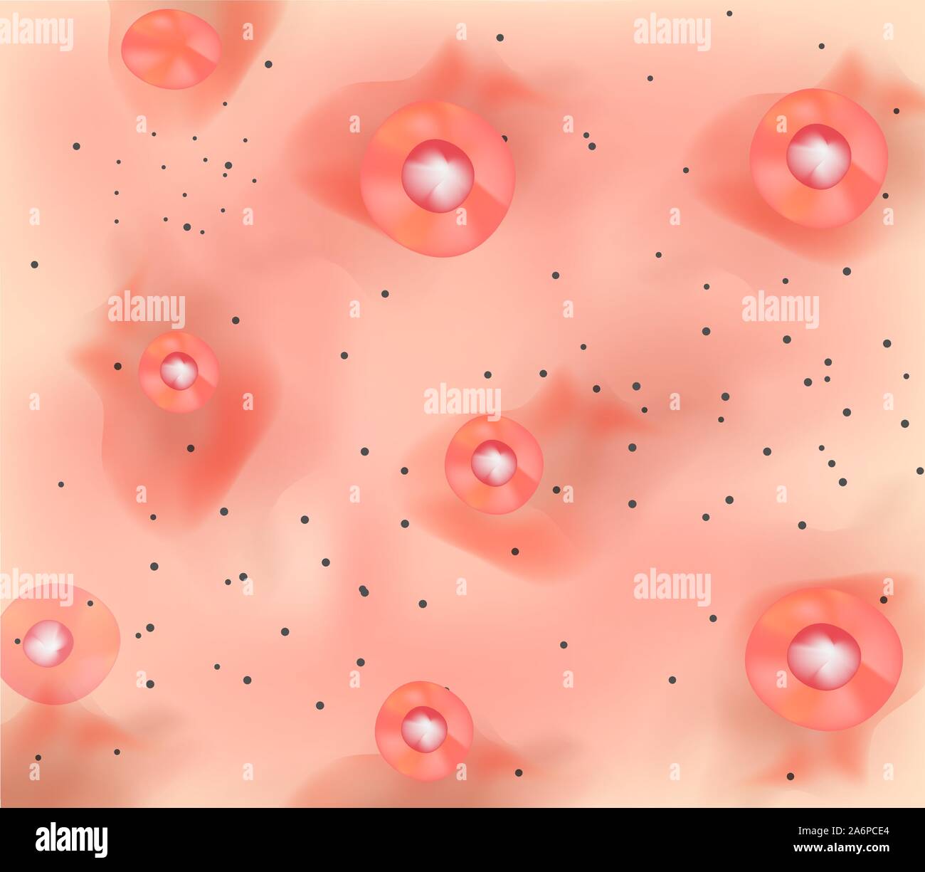 Stage 3 of development of acne. Inflamed skin with scars, acne and ...