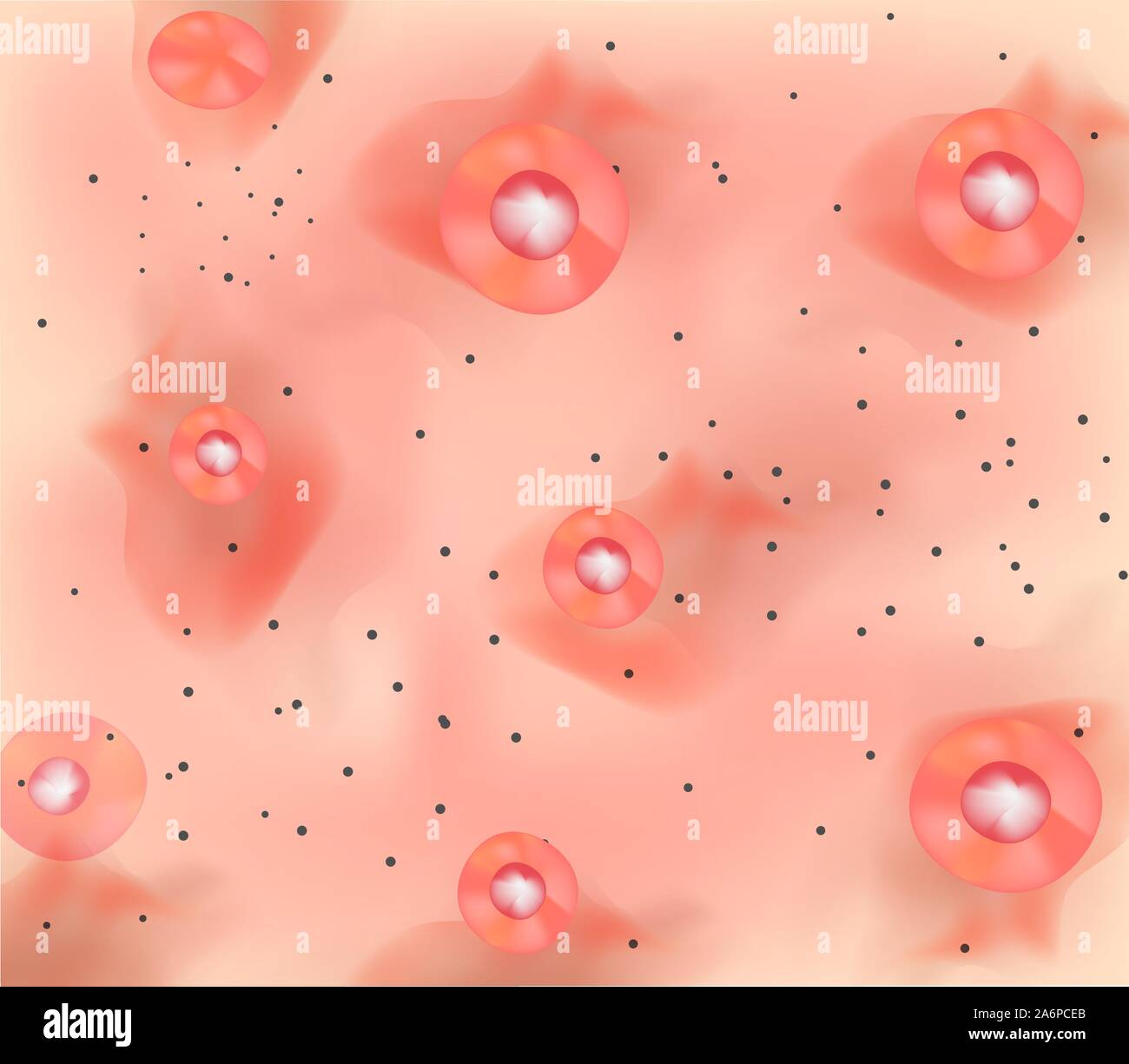 Stage 3 of development of acne. Inflamed skin with scars, acne and ...