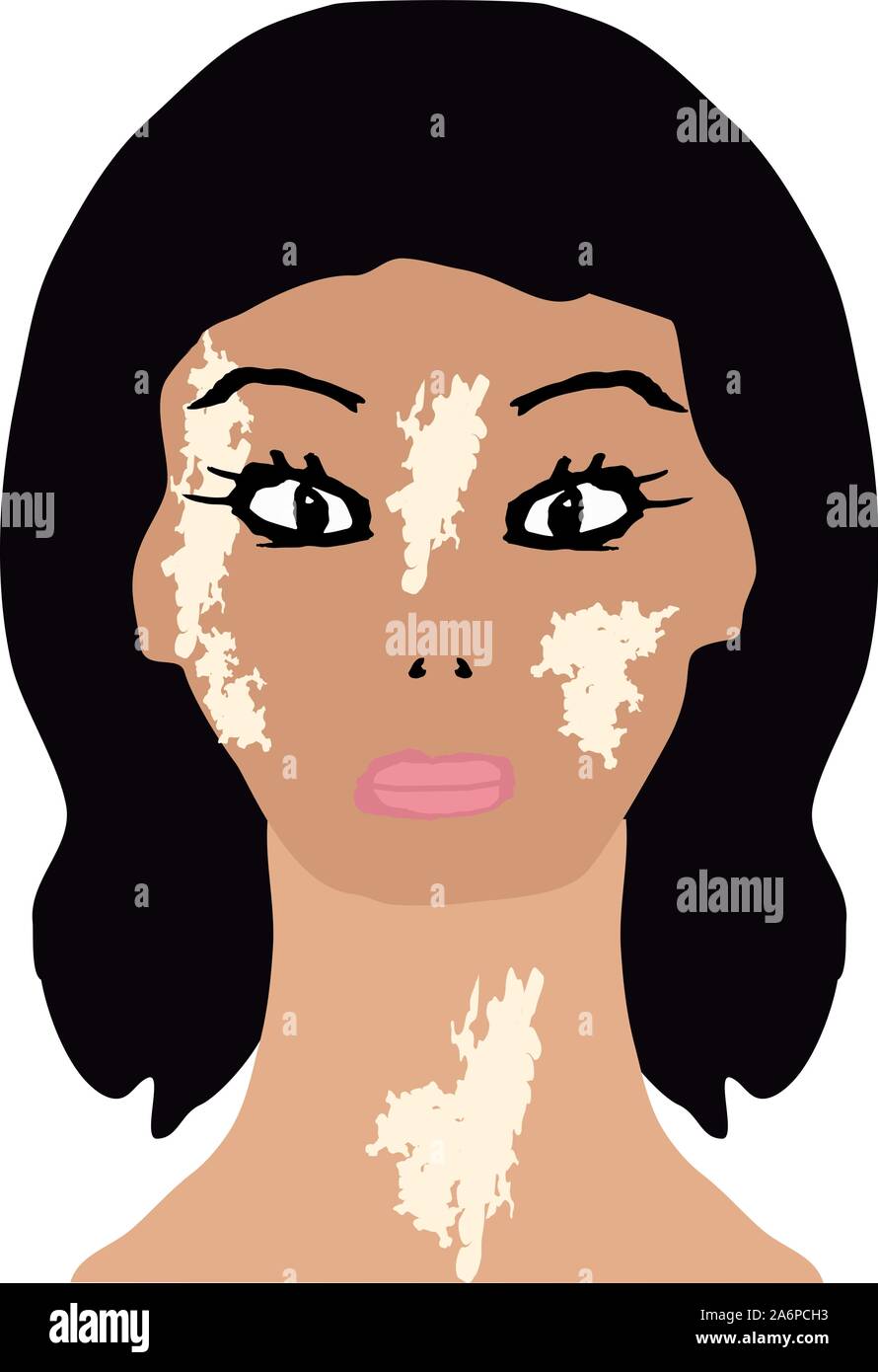 World Vitiligo Day. Infographics. Vector illustration on isolated ...