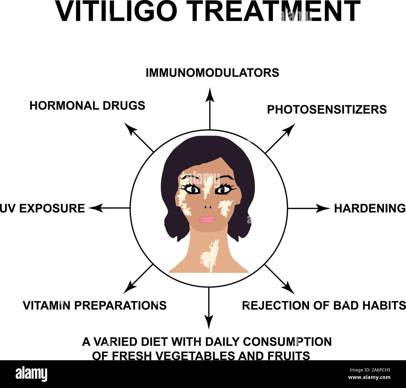 Treatment of vitiligo. World Vitiligo Day. Infographics. Vector ...