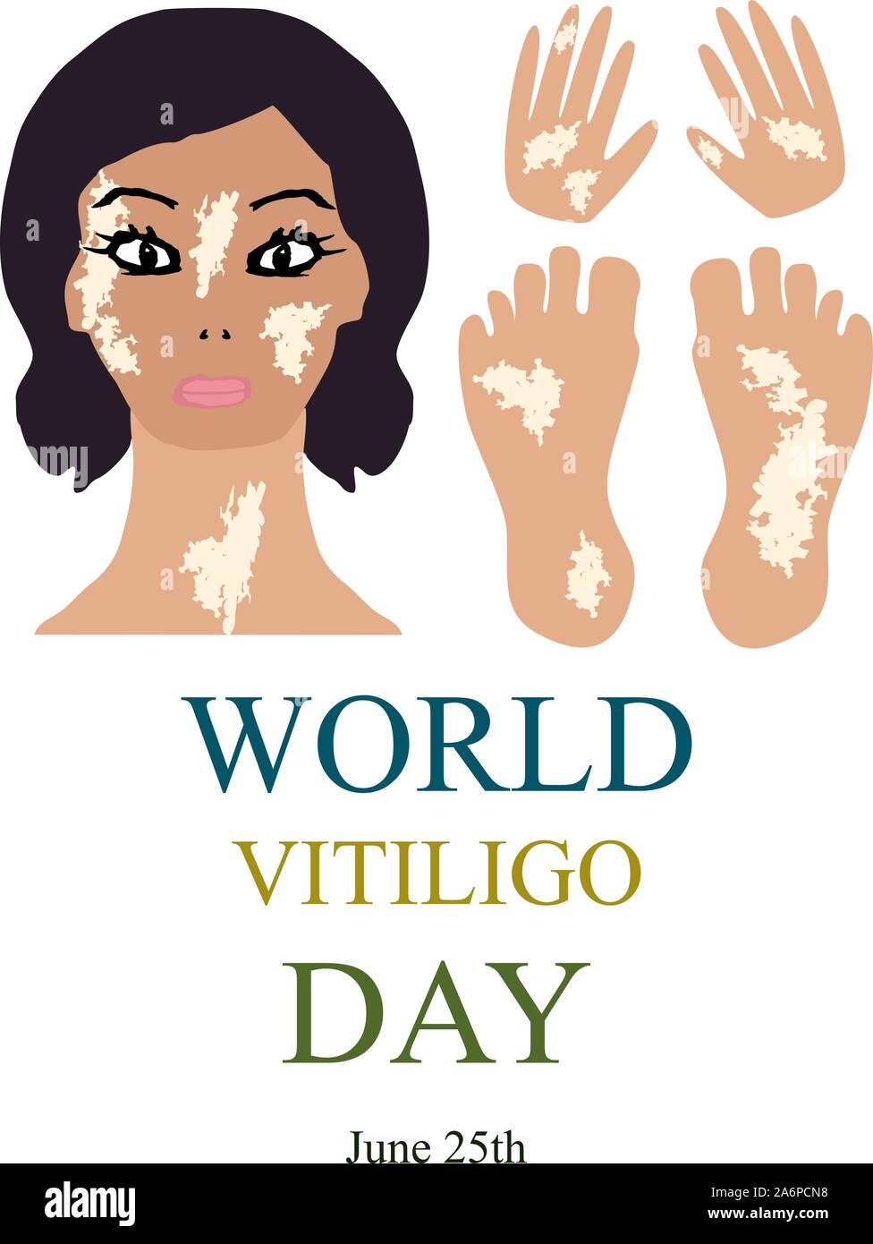 World Vitiligo Day. Infographics. Vector illustration on isolated ...