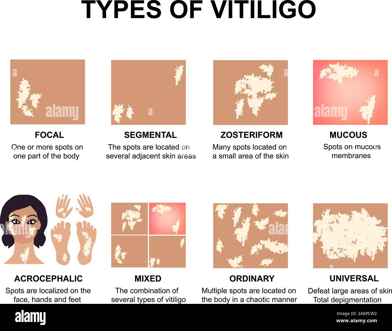 Types of vitiligo. World Vitiligo Day. Infographics. Vector ...