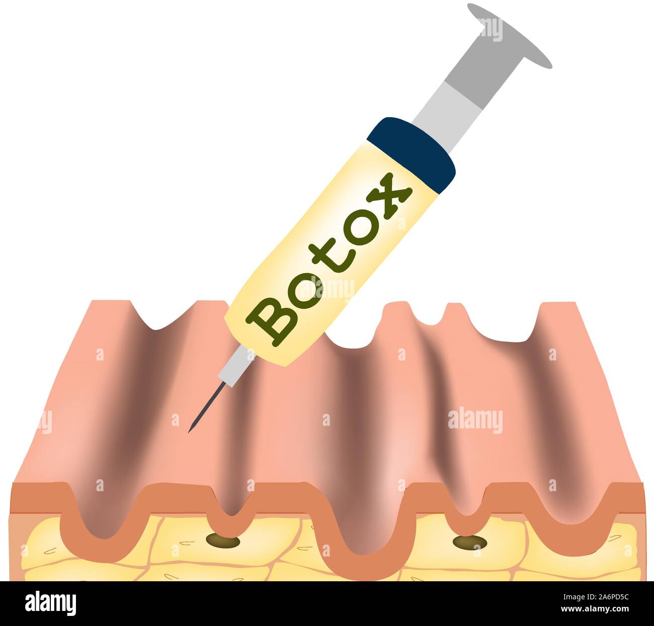 Wrinkles on the skin. Botox wrinkle treatment. Anatomical skin ...