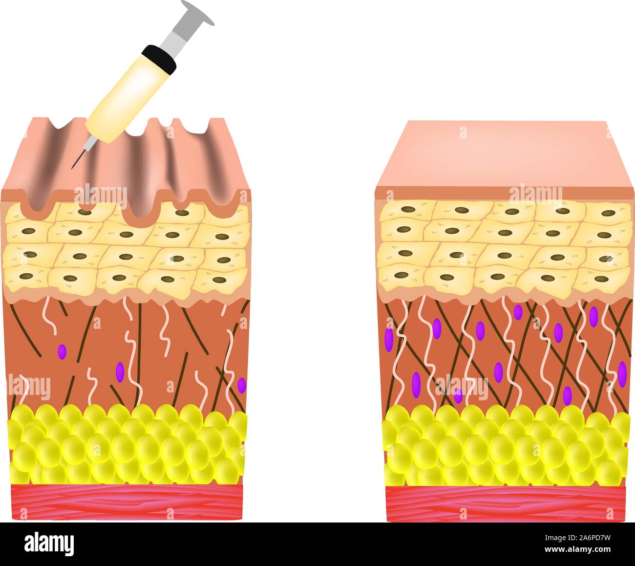 Wrinkles on the skin. Botox wrinkle treatment. Anatomical skin ...