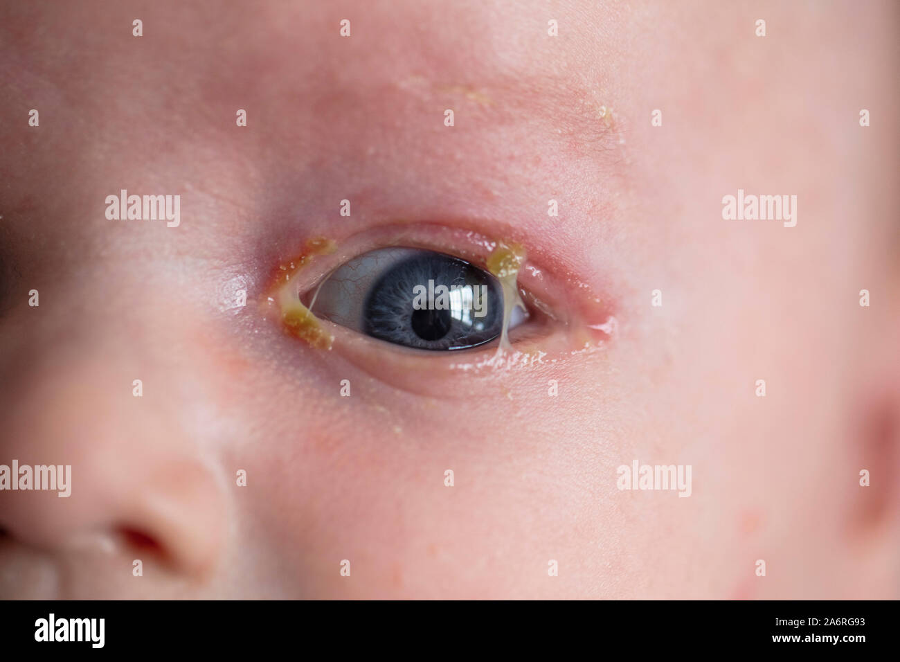 Conjunctivitis child hi-res stock photography and images - Alamy