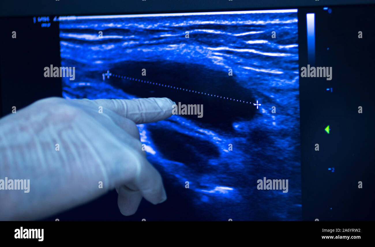EPI Intratissue Percutaneous Electrolysis dry needling ultrasound ecography scan physiotherapy ...