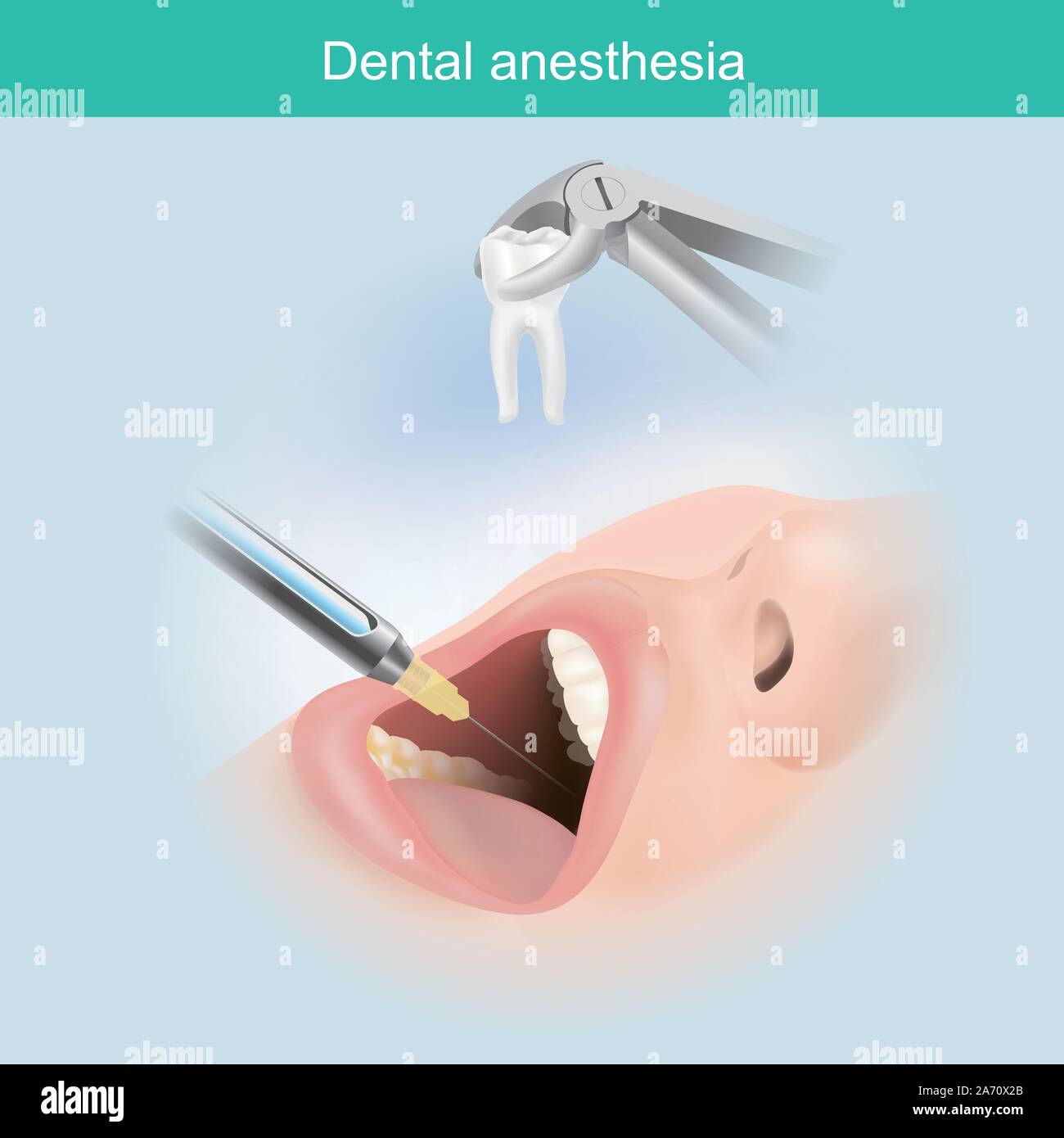 Dental anaesthesia. A jet injection aims a liquid medication dose for ...