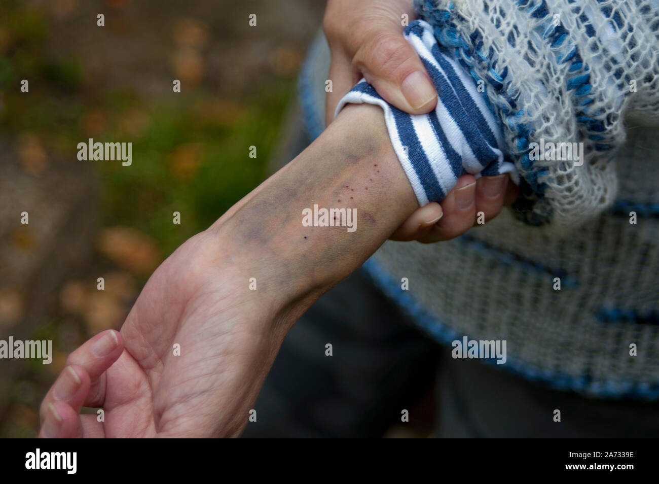 Extravasation hi-res stock photography and images - Alamy