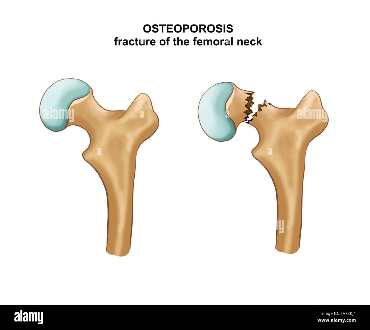 Femoral neck fracture hi-res stock photography and images - Alamy