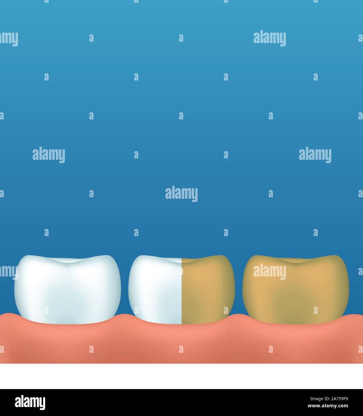Dental crown before after Stock Vector Images - Alamy