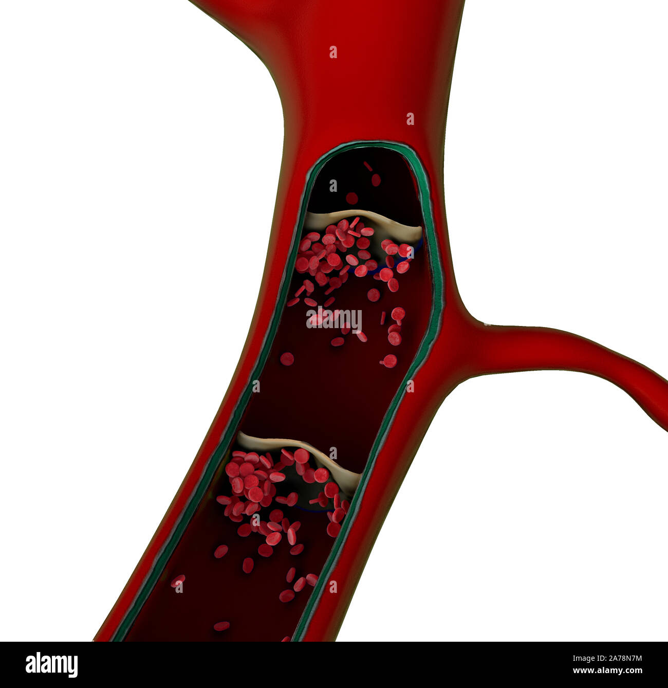 Retinal blood vessels hi-res stock photography and images - Alamy