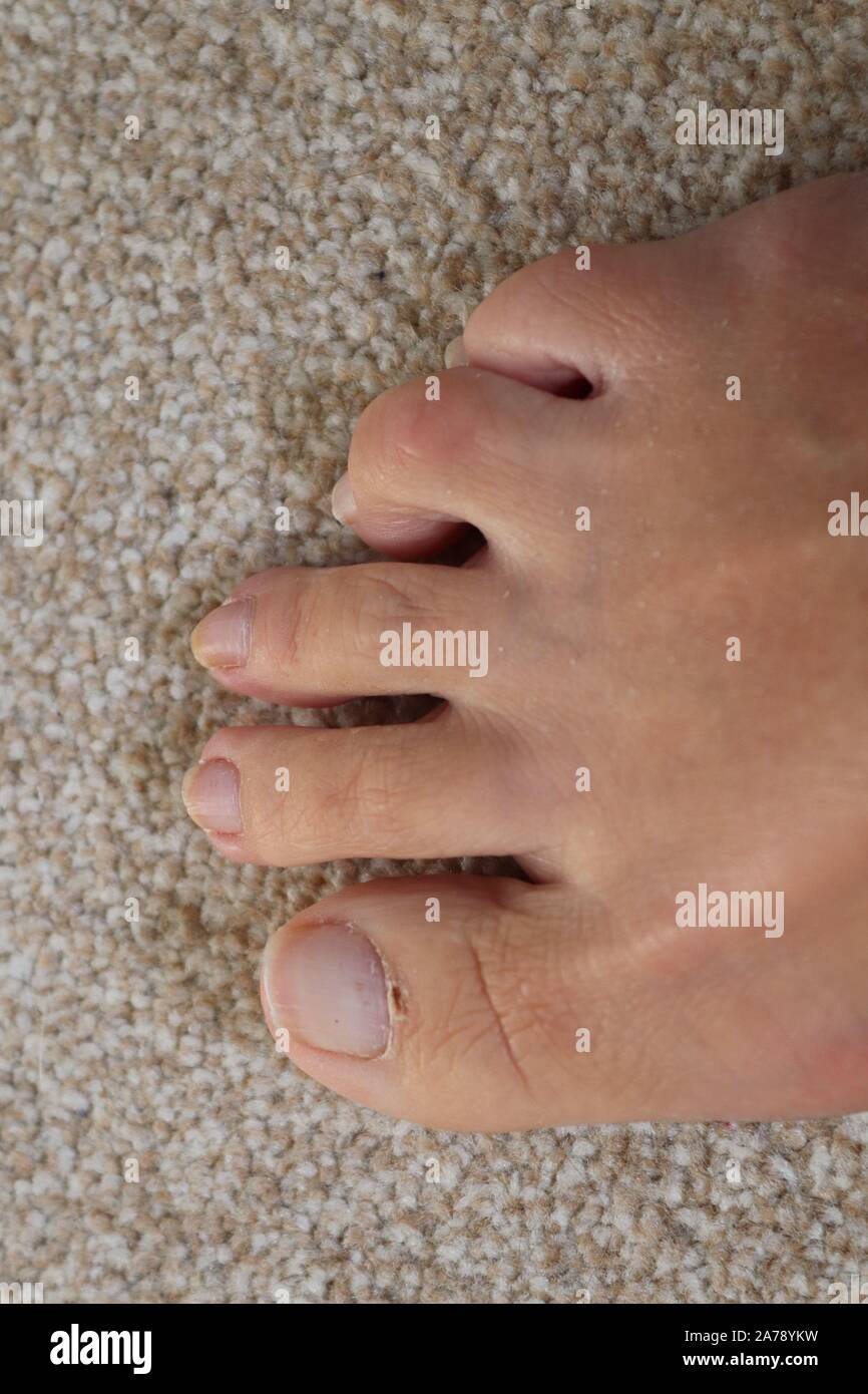 Dryness skin hi-res stock photography and images - Alamy