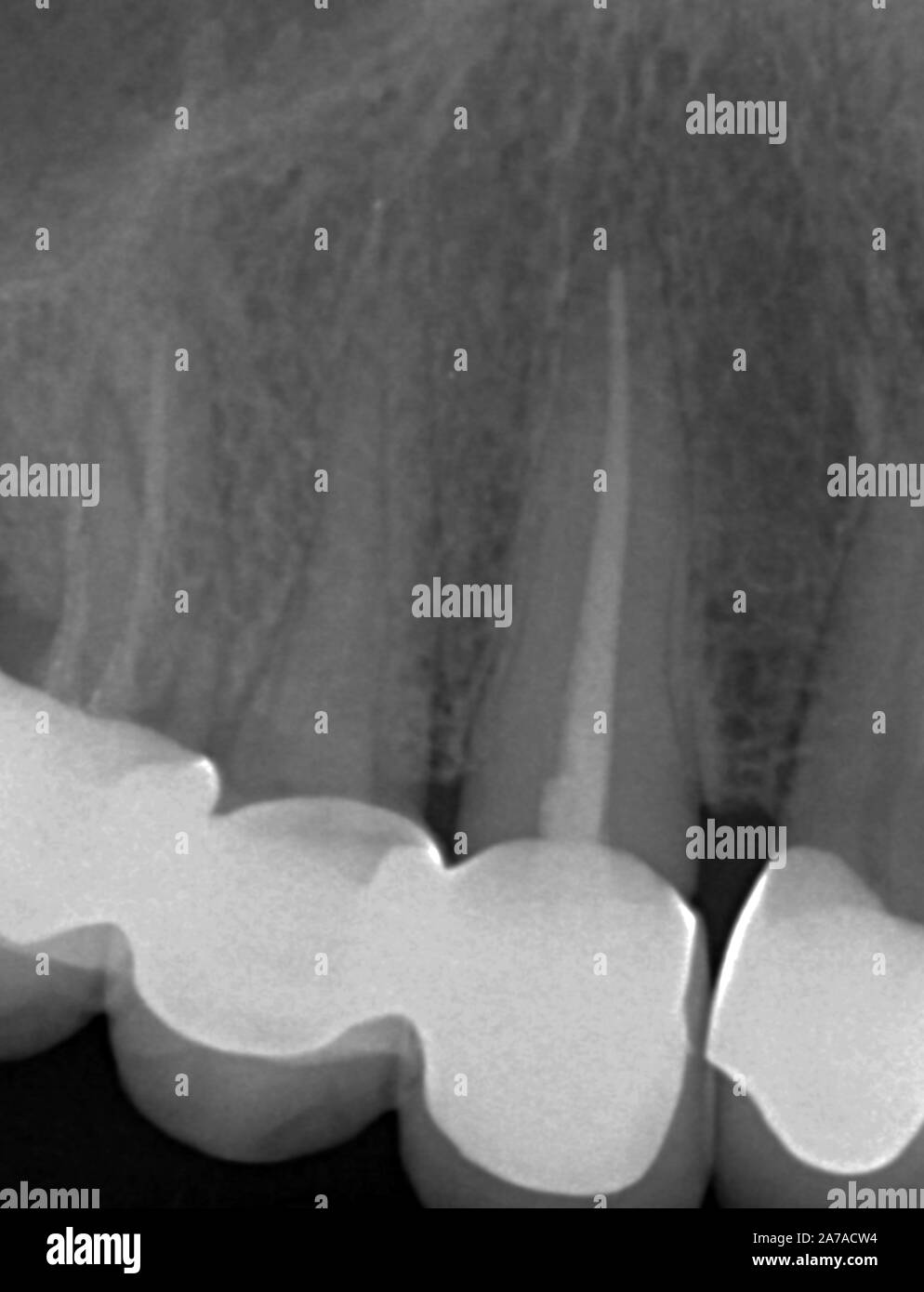 X-ray image close-up of tooth root treatment Stock Photo - Alamy