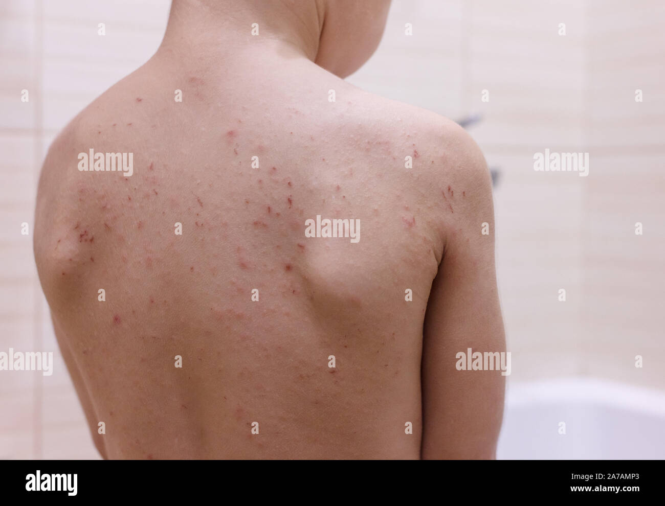 Child's back. Eczema atopic dermatitis symptom skin. Symptom Stock Photo - Alamy
