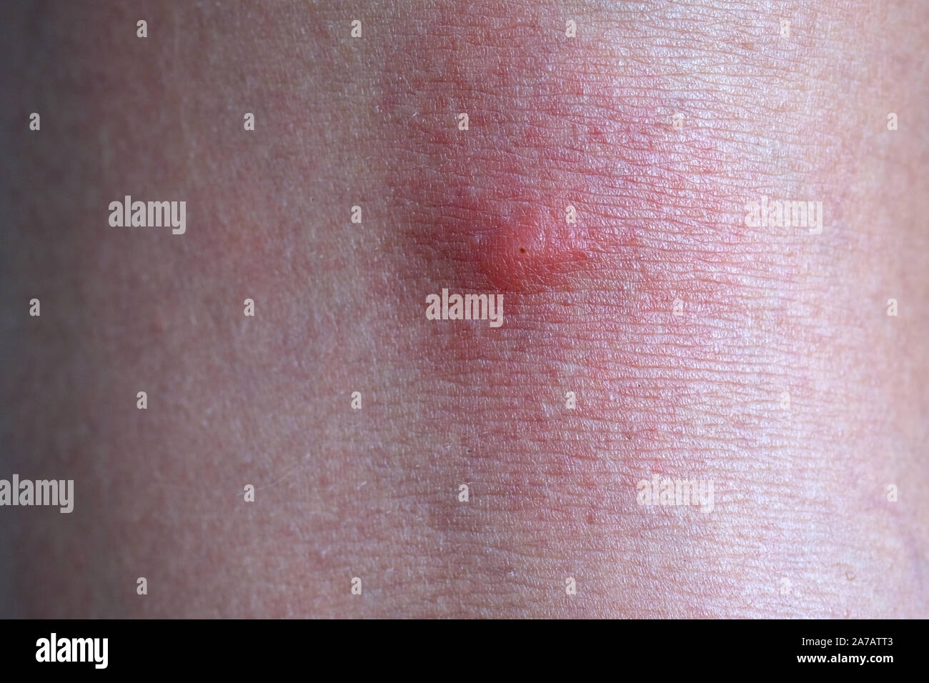 Insect bite on human skin. A reddened and swollen stain on a person’s ...