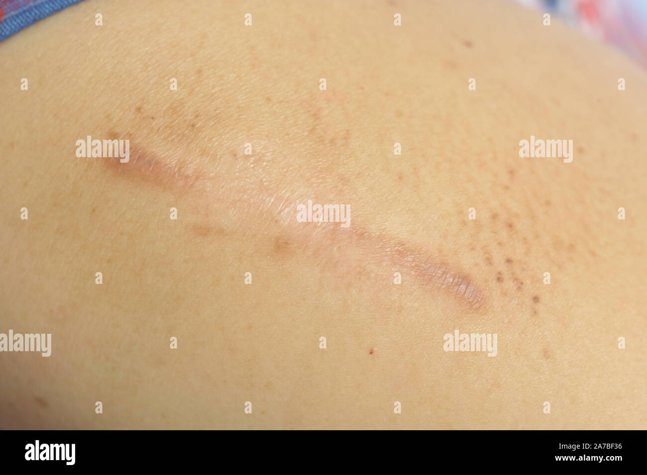 Abdominal scar hi-res stock photography and images - Alamy