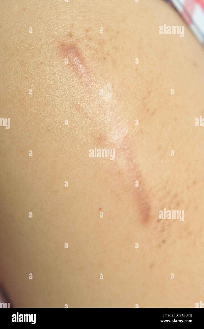 Appendicitis scar hi-res stock photography and images - Alamy
