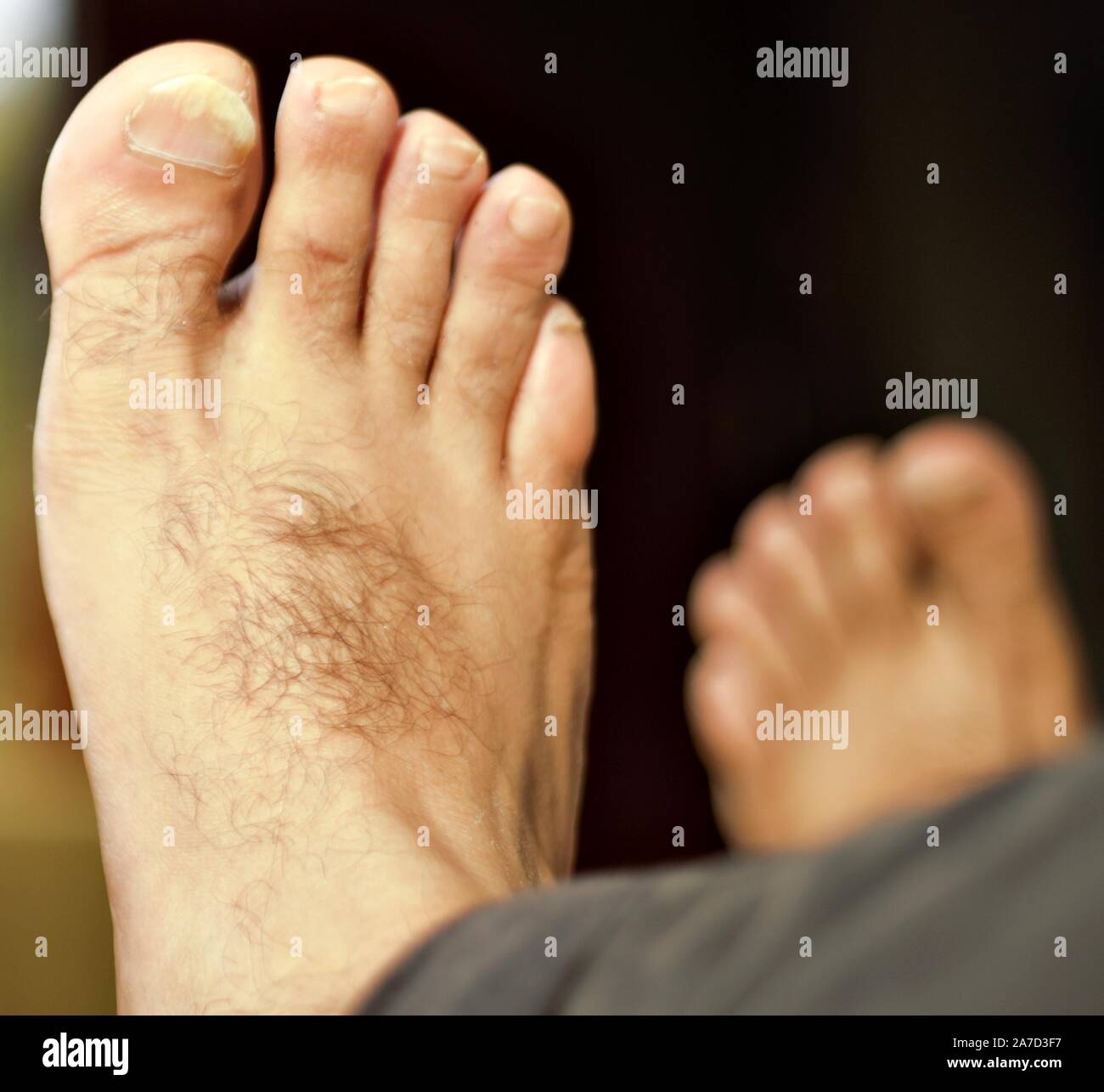 Fungus on toenails. Toenails destroyed. Toenail plate is affected by ...