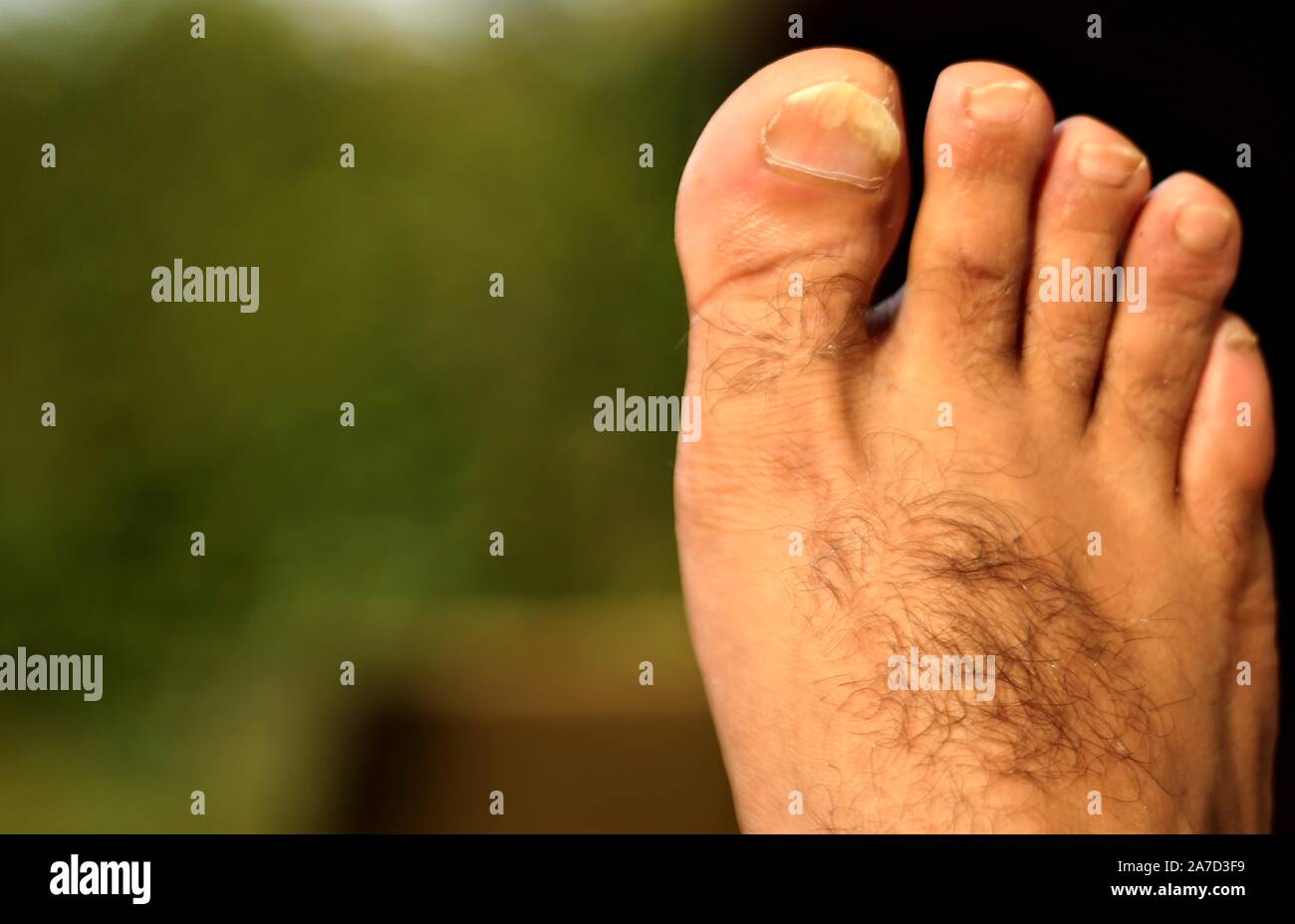 Fungus on toenails. Toenails destroyed. Toenail plate is affected by ...