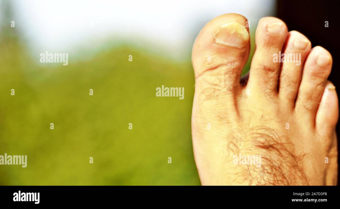 Fungus on toenails. Toenails destroyed. Toenail plate is affected by ...