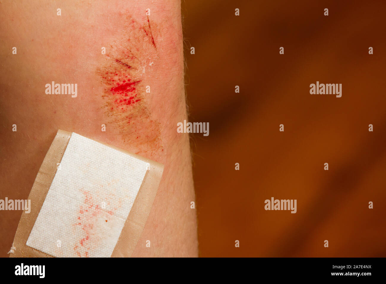 Childhood scar hi-res stock photography and images - Alamy
