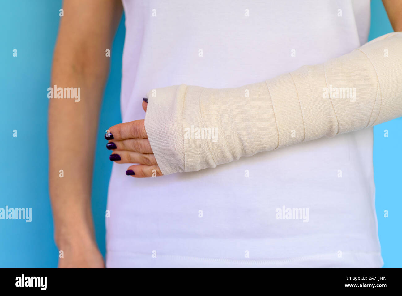 Woman with broken arm bone in cast, plastered hand on blue background ...