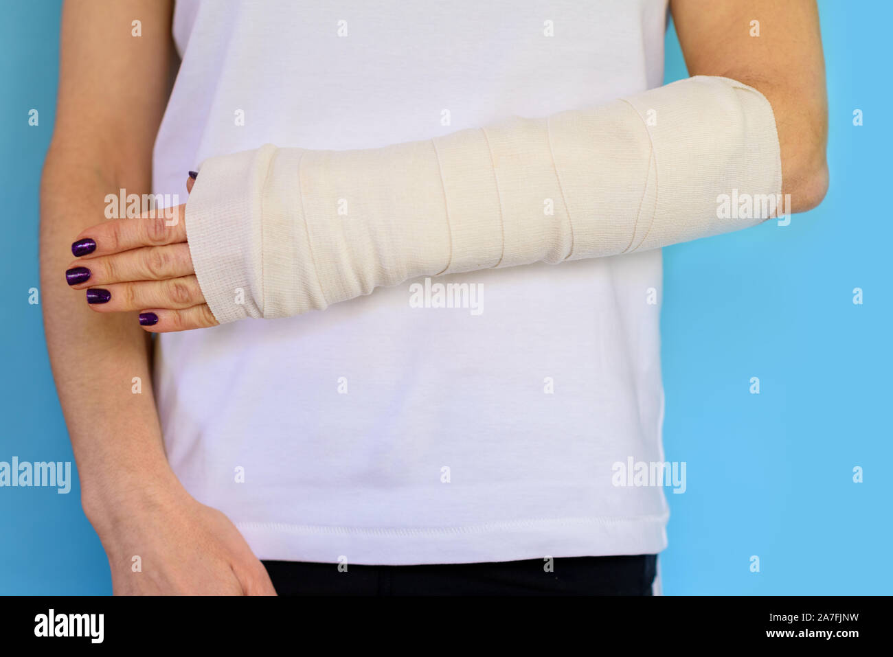 Woman Broken Arm Cast High Resolution Stock Photography and Images - Alamy