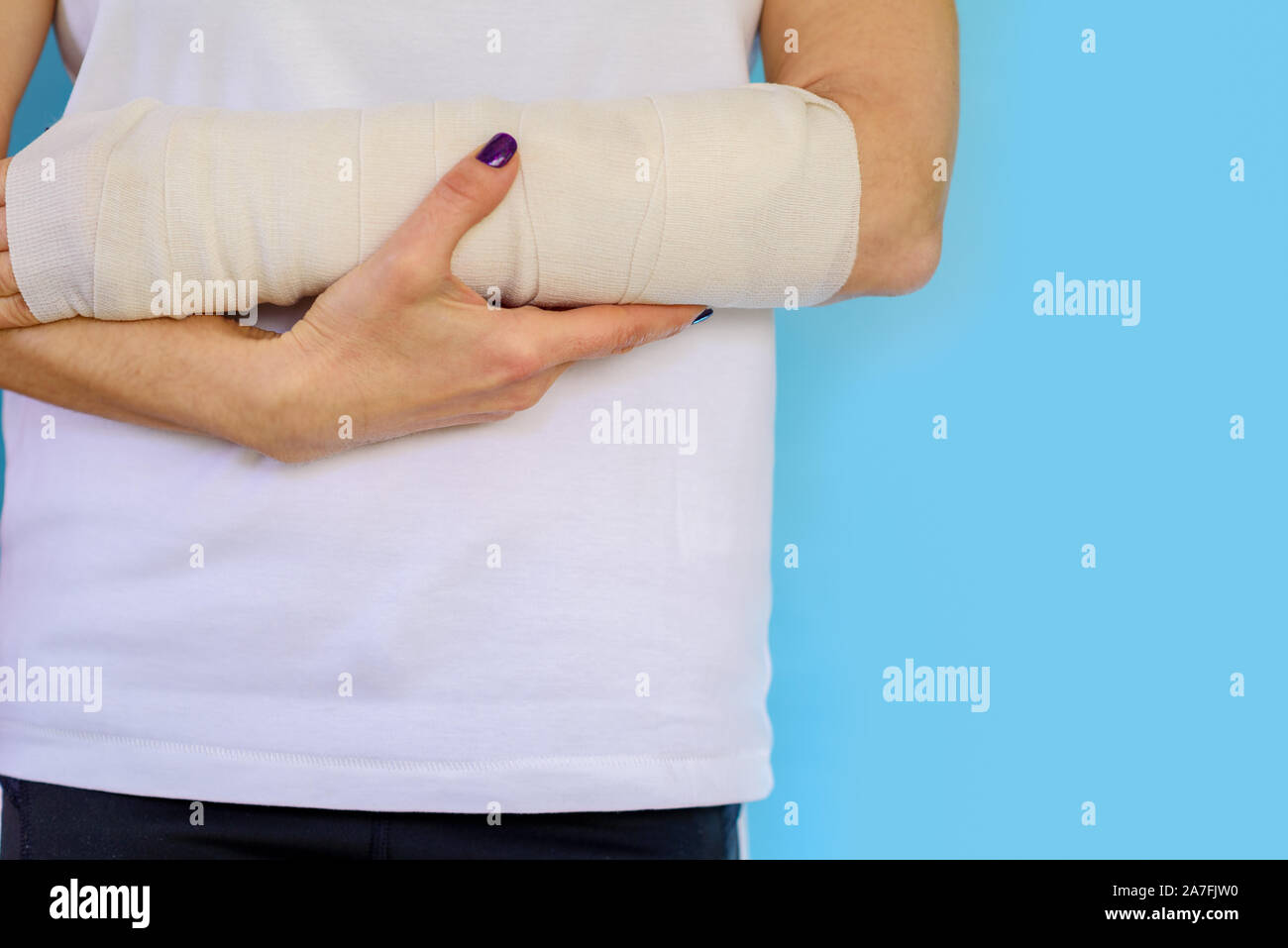 Broken Arm Cast High Resolution Stock Photography and Images - Alamy