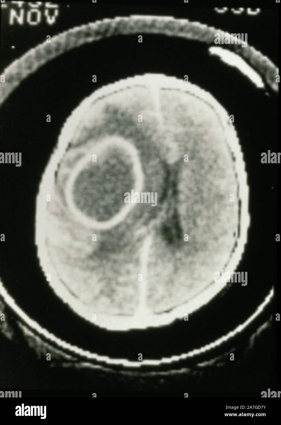 Brain abscess hi-res stock photography and images - Alamy