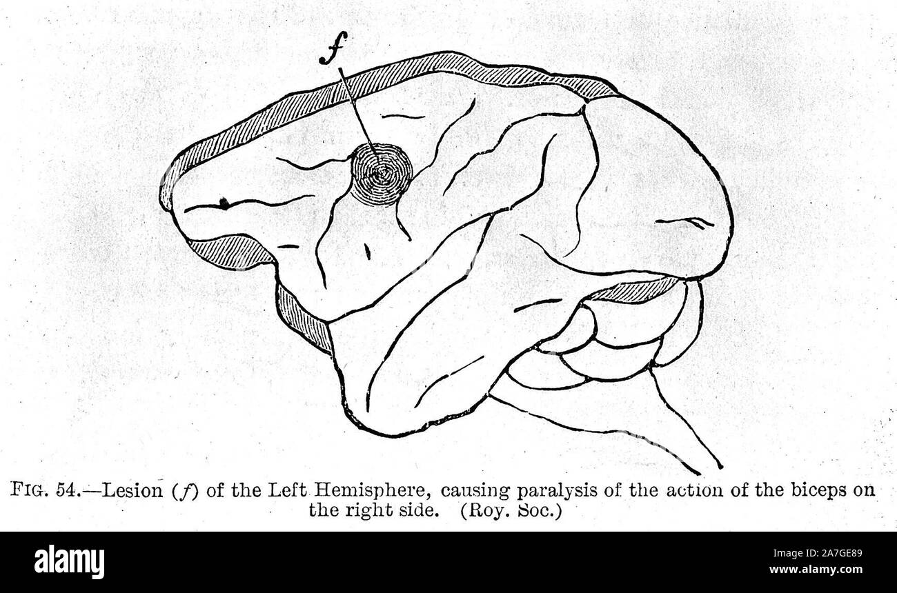 Brain Lesion High Resolution Stock Photography and Images - Alamy