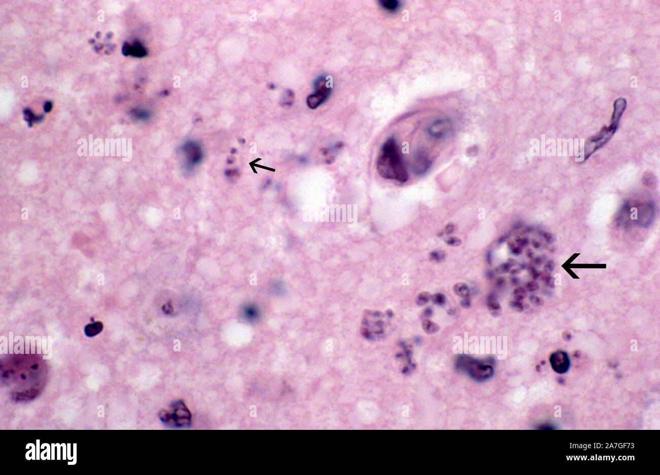 Cerebral toxoplasmosis hi-res stock photography and images - Alamy