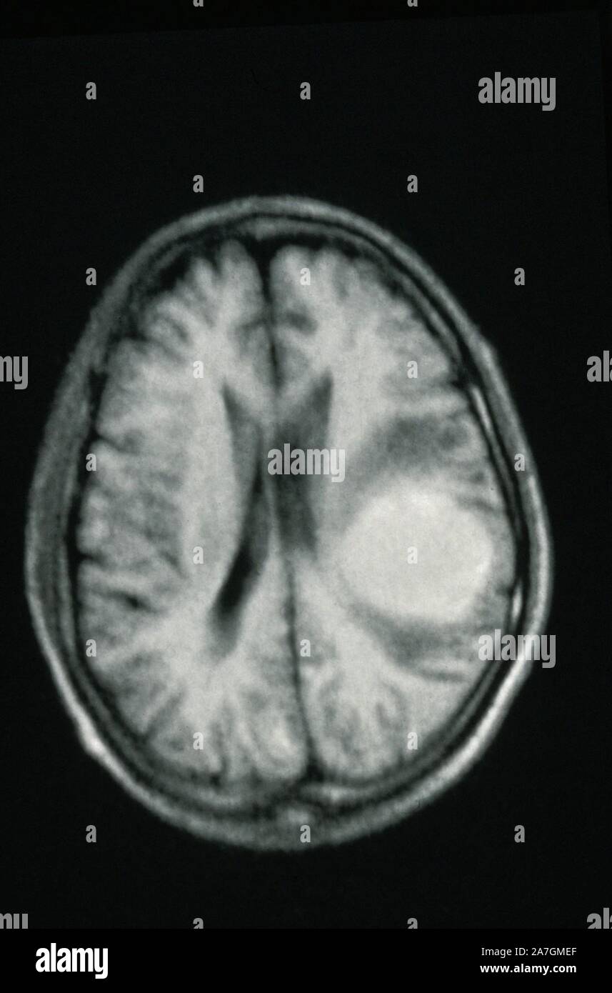 Metastasis High Resolution Stock Photography and Images - Alamy