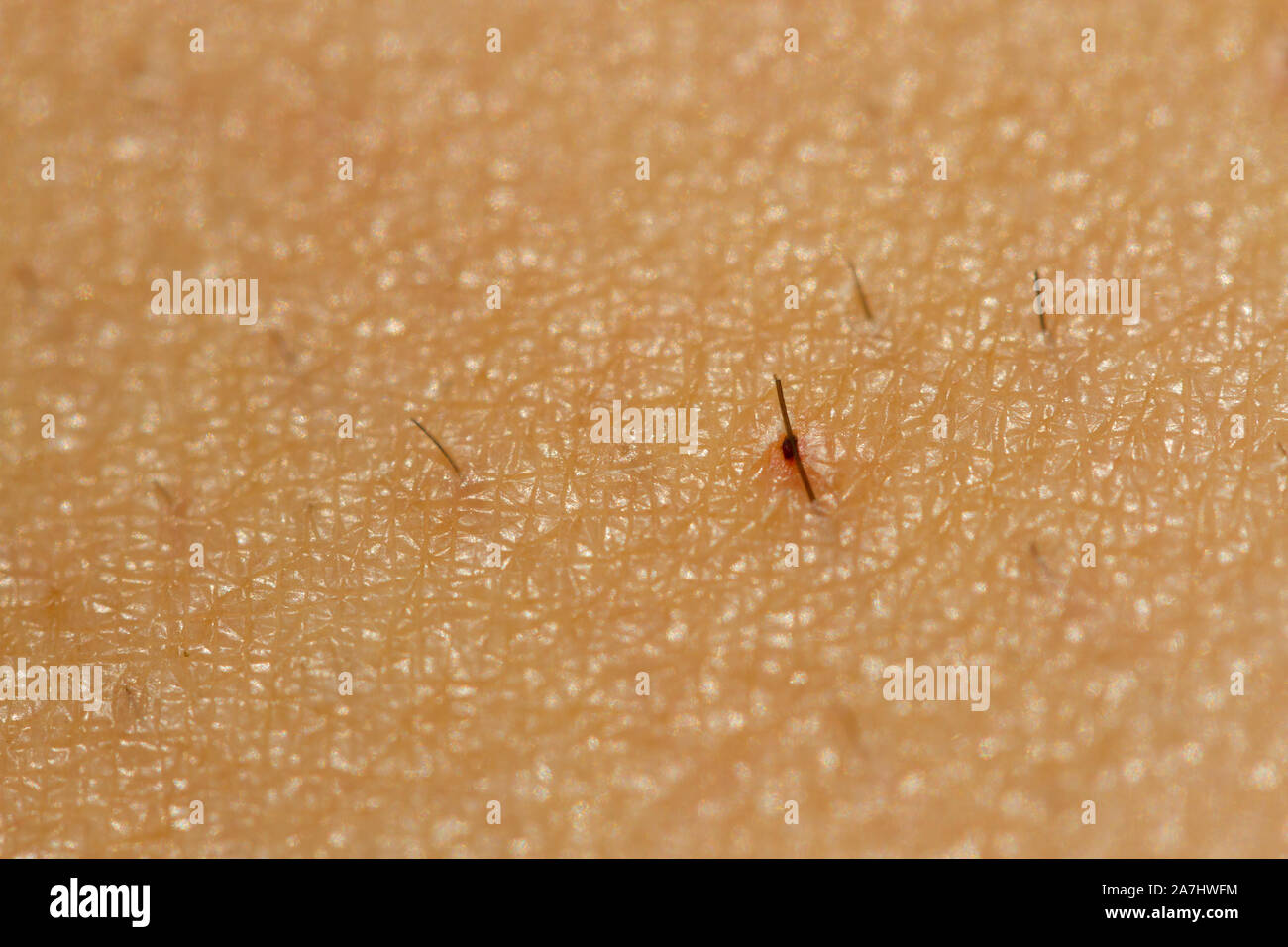 Close up of a scar on skin. Depilation Stock Photo - Alamy