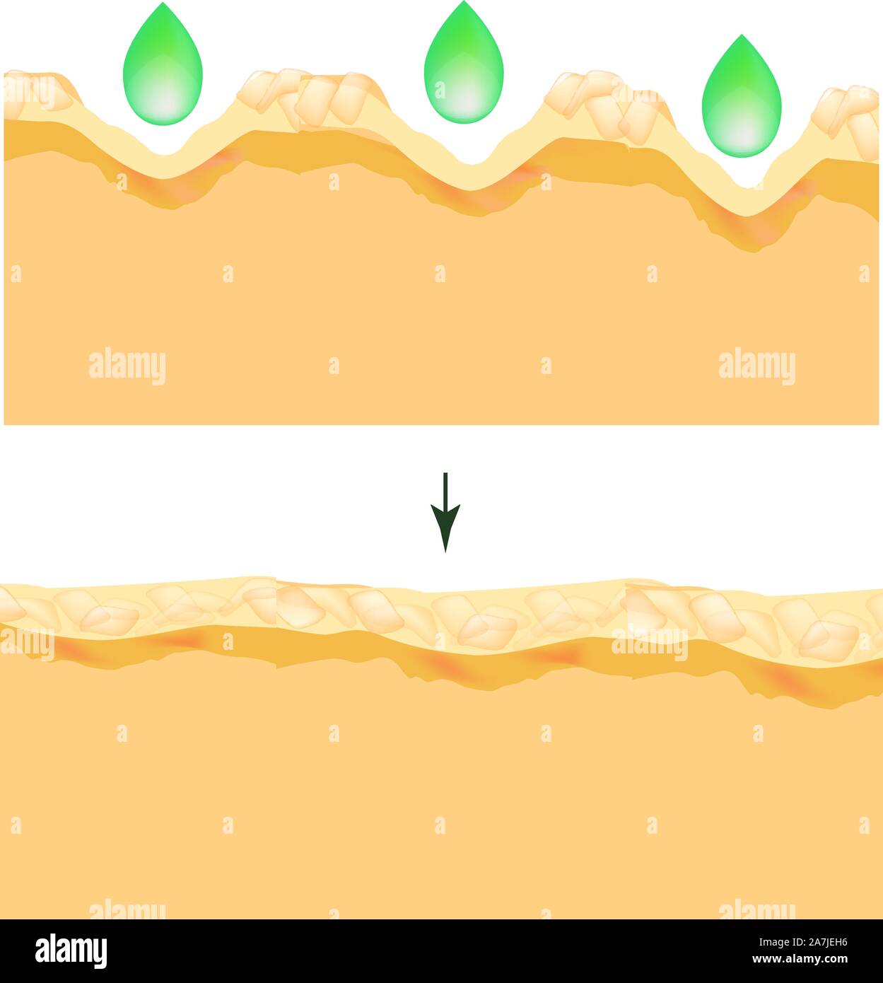 Enlarged pores. The structure of the skin. Wrinkles, acne scar ...