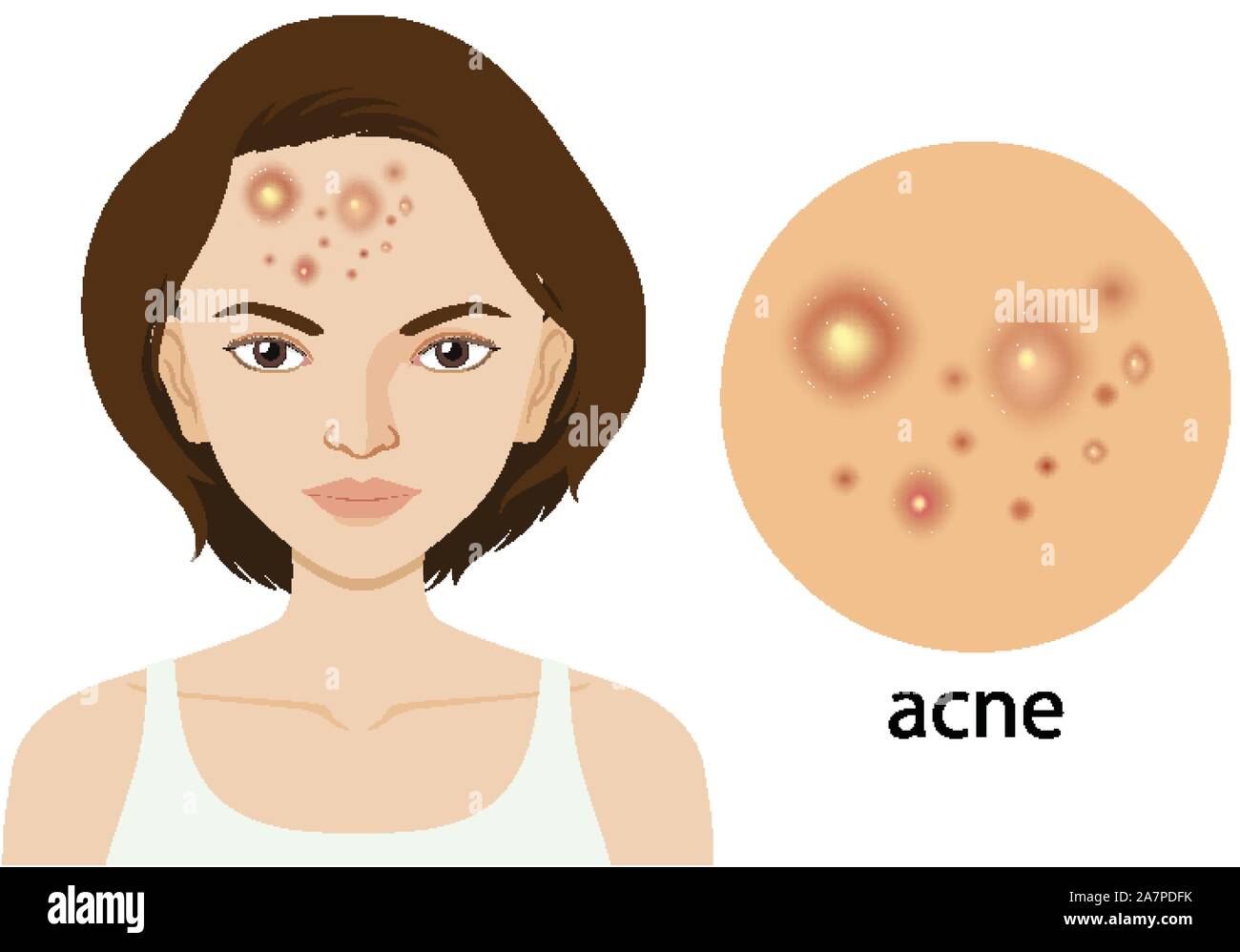 Diagram showing woman with acne problem illustration Stock Vector Image ...
