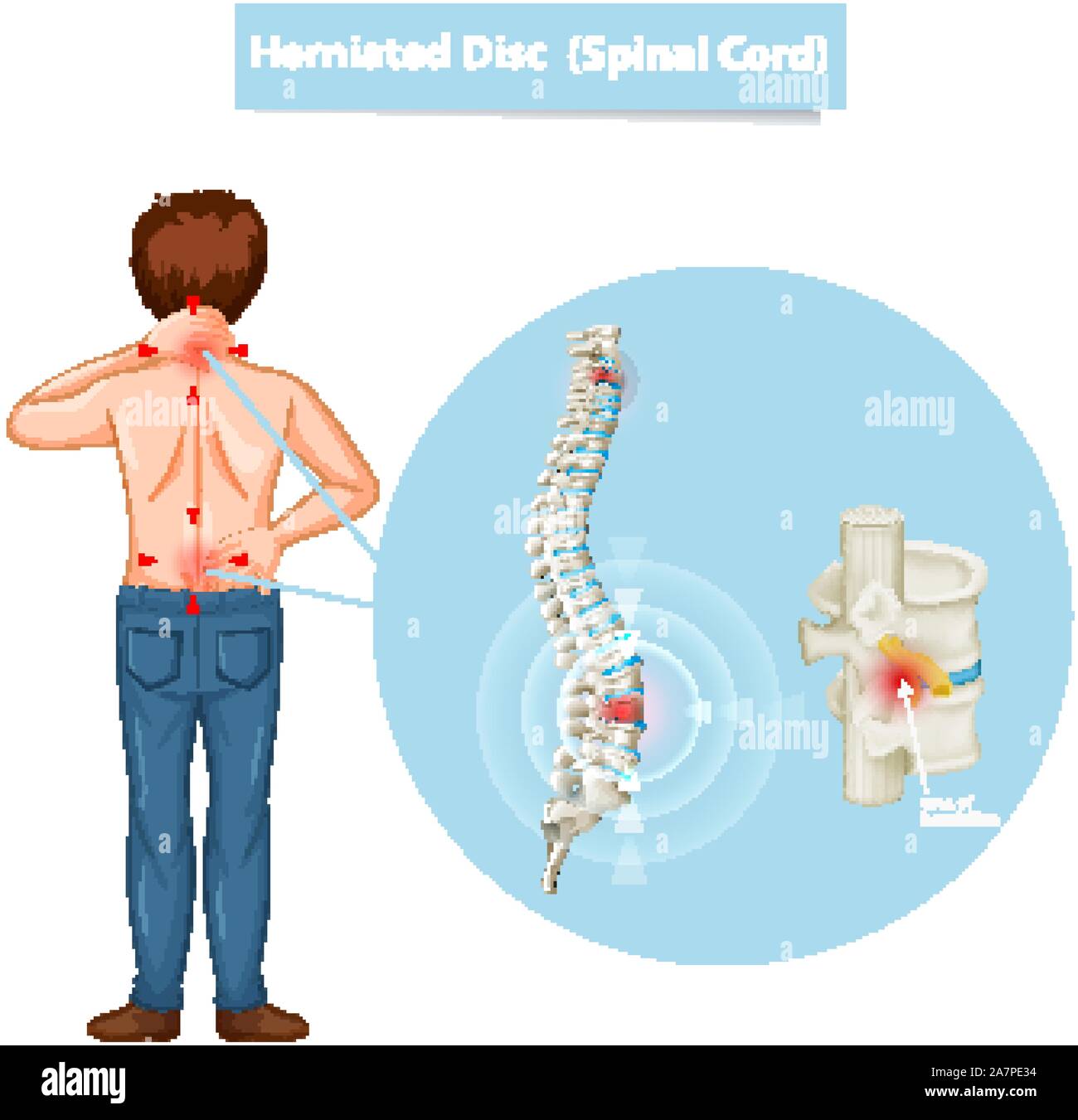 Herniated disc illustration Cut Out Stock Images & Pictures - Alamy