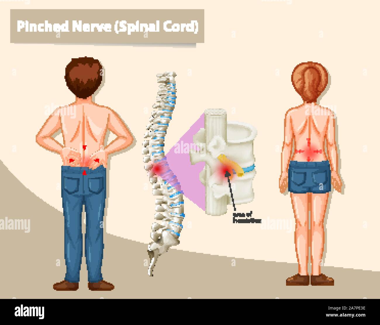 Diagram showing pinched nerve in human illustration Stock Vector Image ... Diagram showing pinched nerve in human illustration Stock Vector Image ...