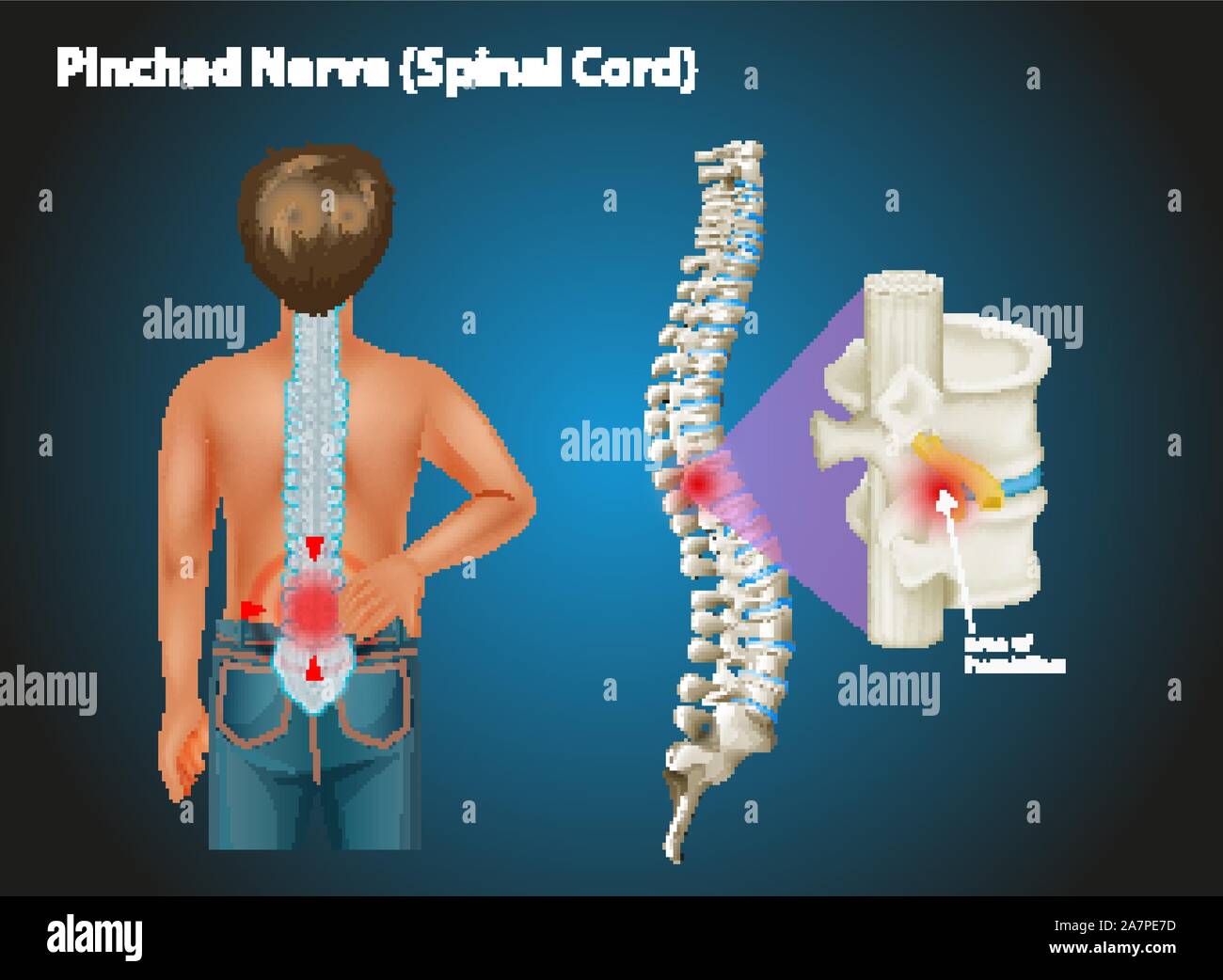Spinal cord pathology Stock Vector Images - Alamy