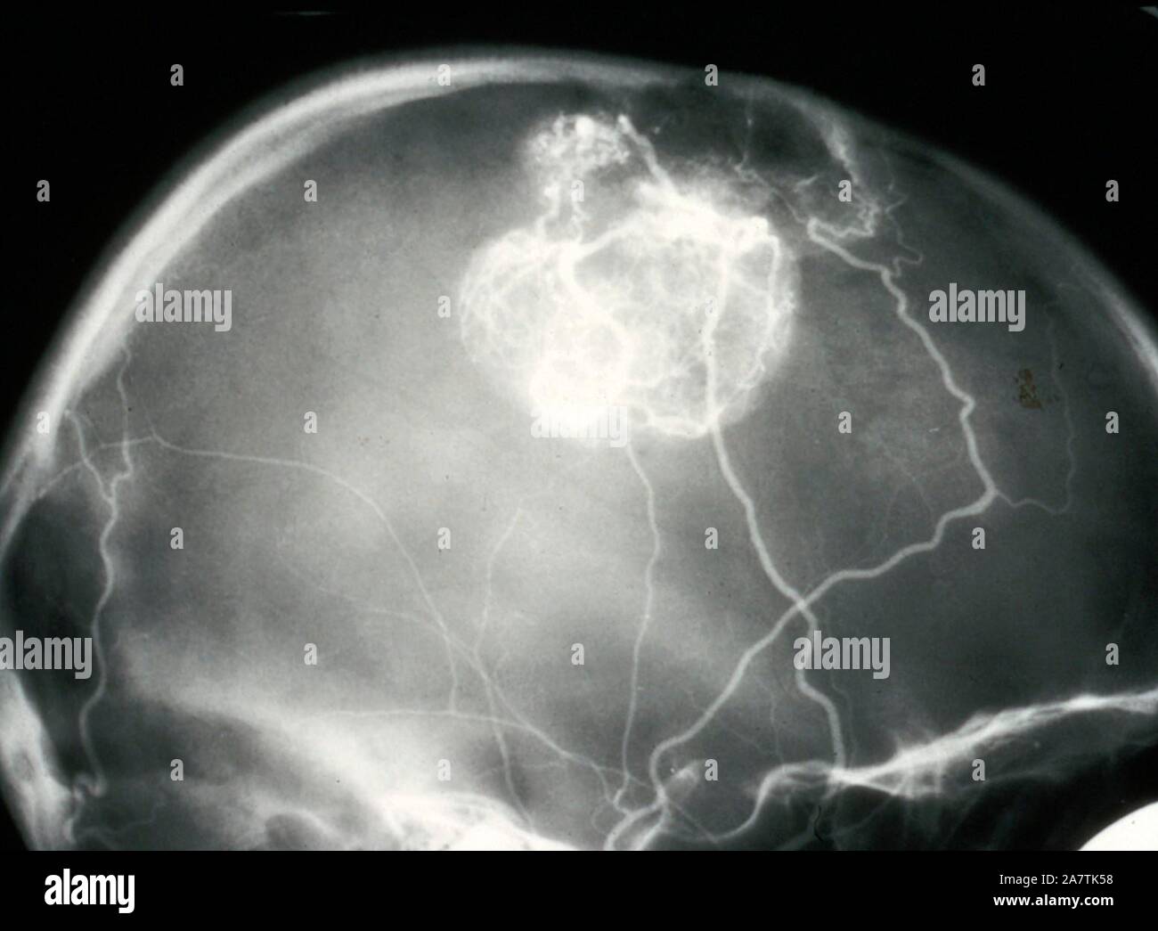 Brain Angiogram High Resolution Stock Photography and Images - Alamy
