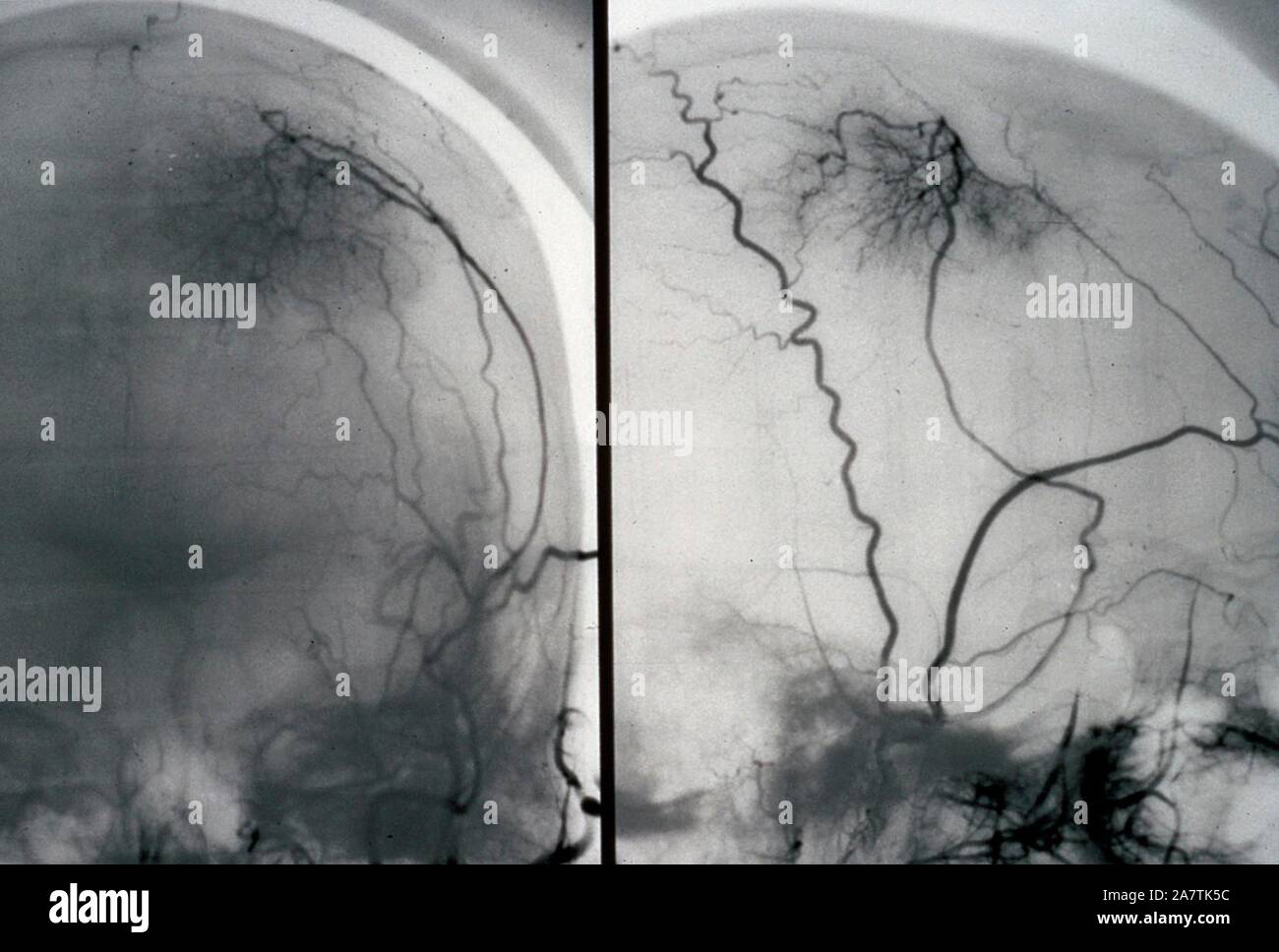 Angiogram head hi-res stock photography and images - Alamy