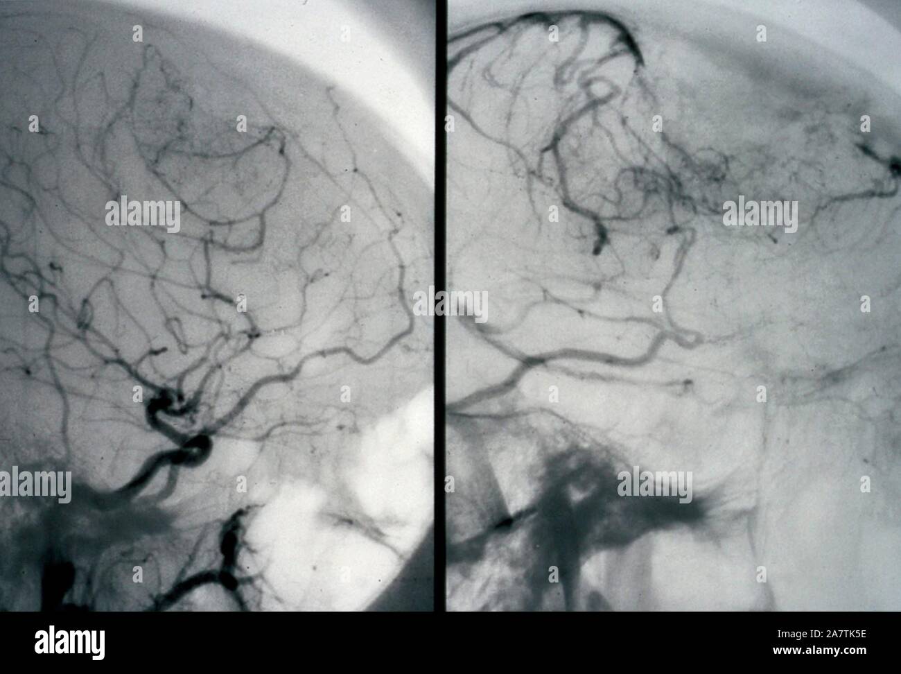 Angiogram head hi-res stock photography and images - Alamy